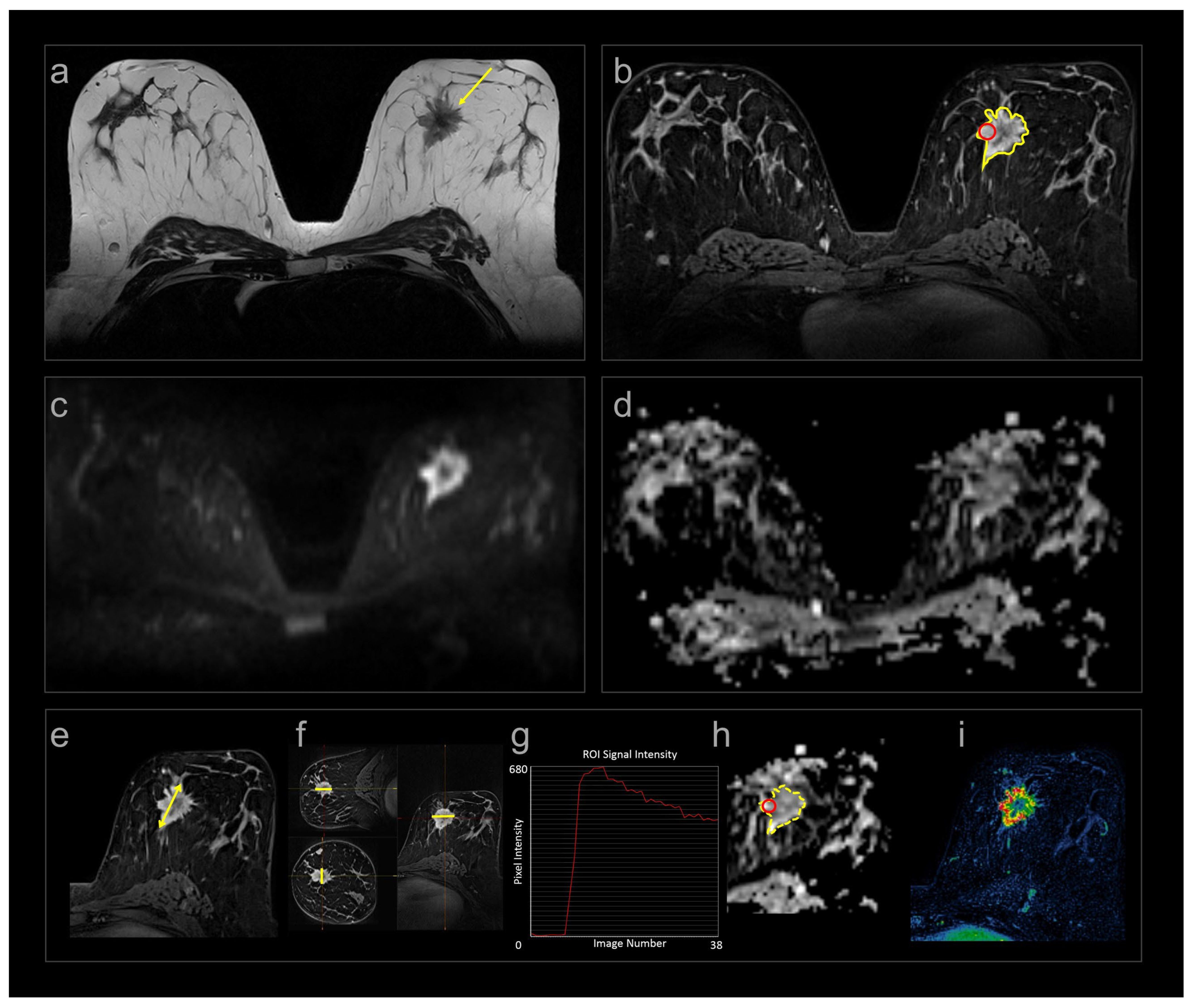MRI for Predicting Response and 10-Year Outcome of Neoadjuvant ...