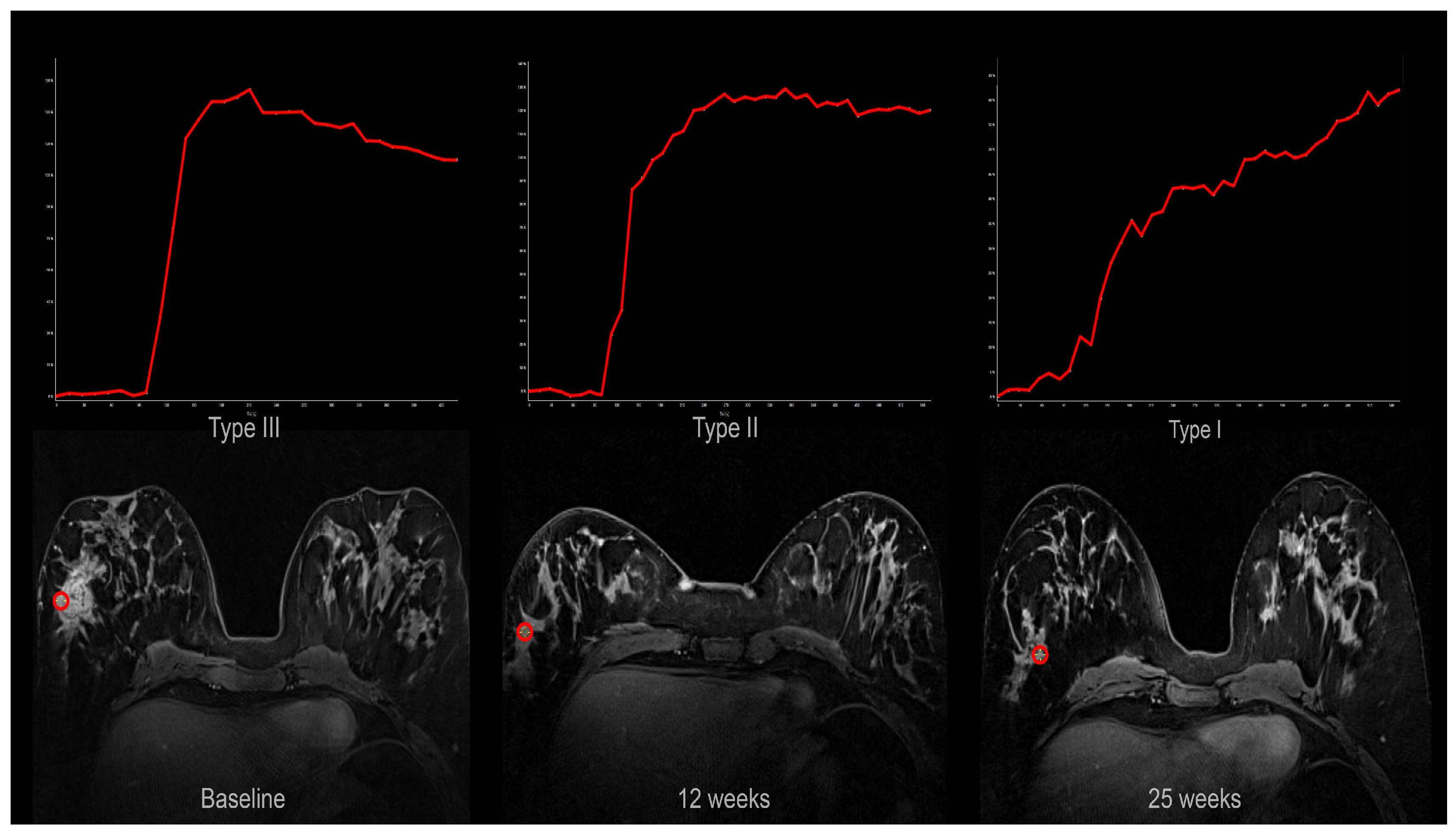 MRI for Predicting Response and 10-Year Outcome of Neoadjuvant ...