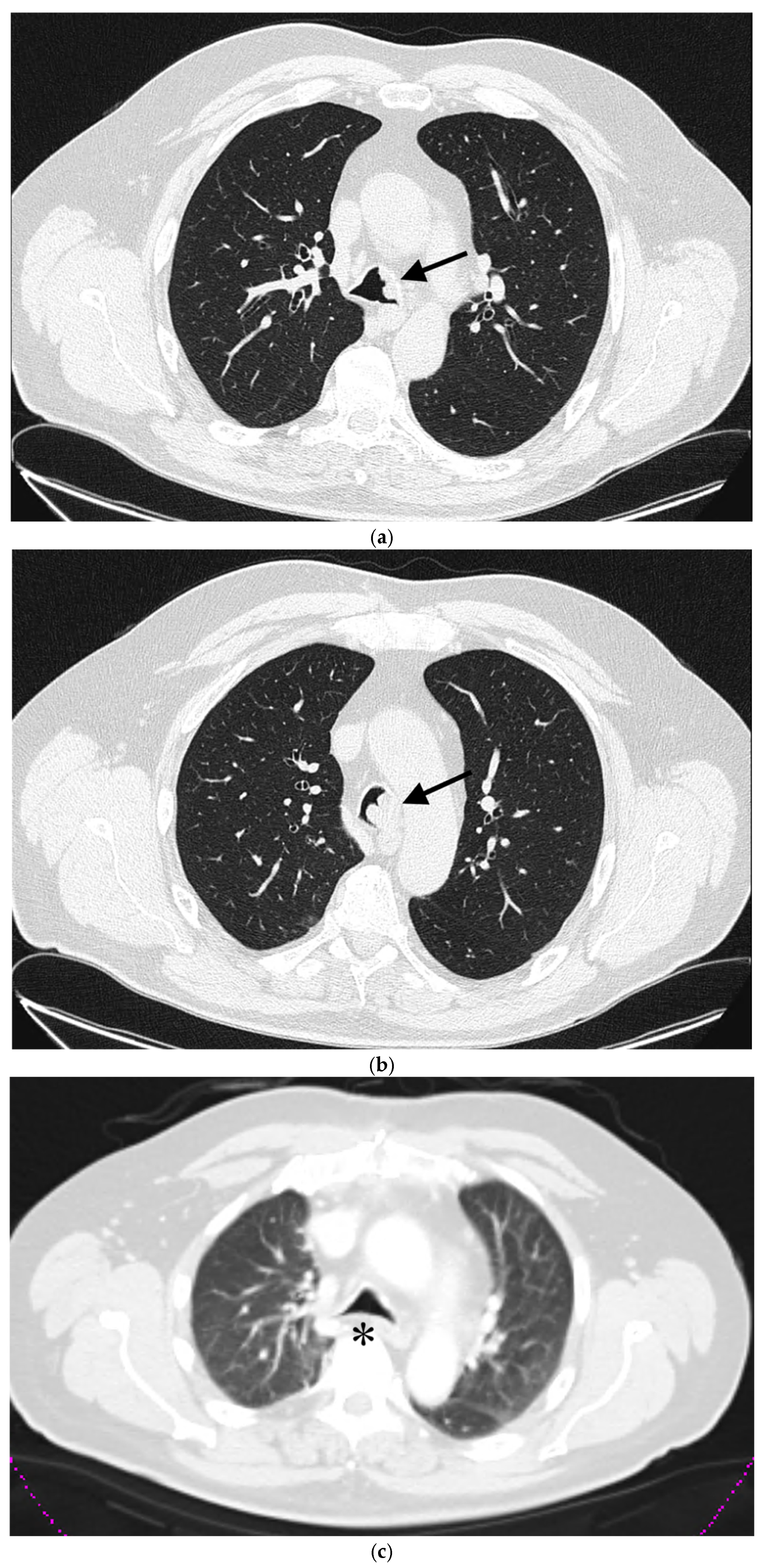 Technical Options and Airway Management in Carinal Resections