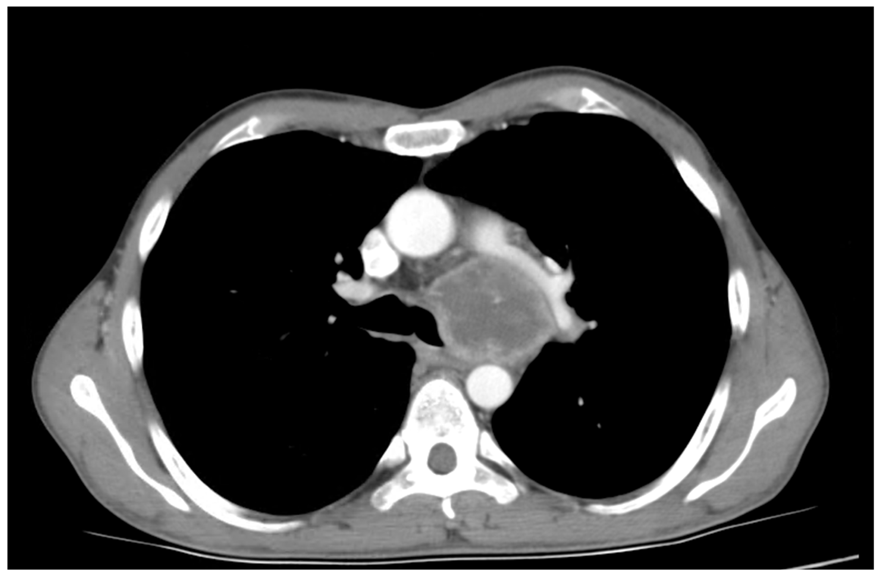 Technical Options and Airway Management in Carinal Resections