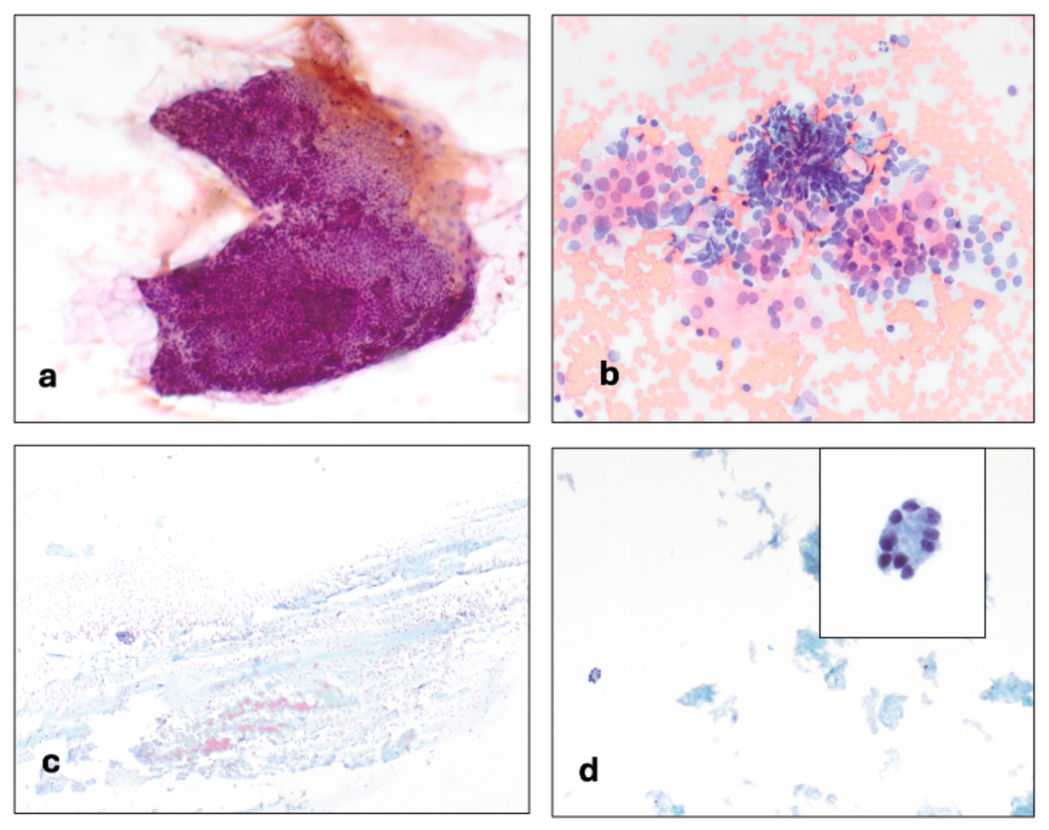 The Role of Cytology, Histology and Molecular Pathology in the ...