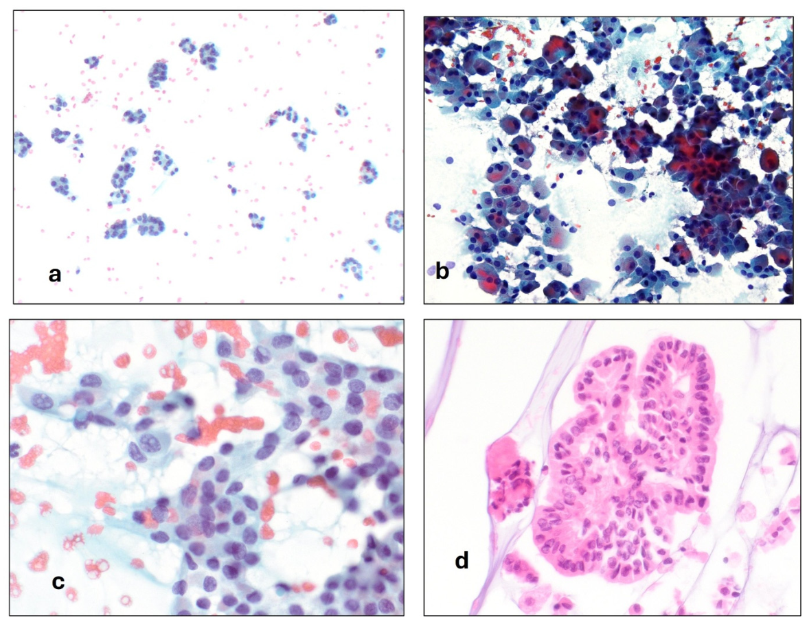 The Role of Cytology, Histology and Molecular Pathology in the ...
