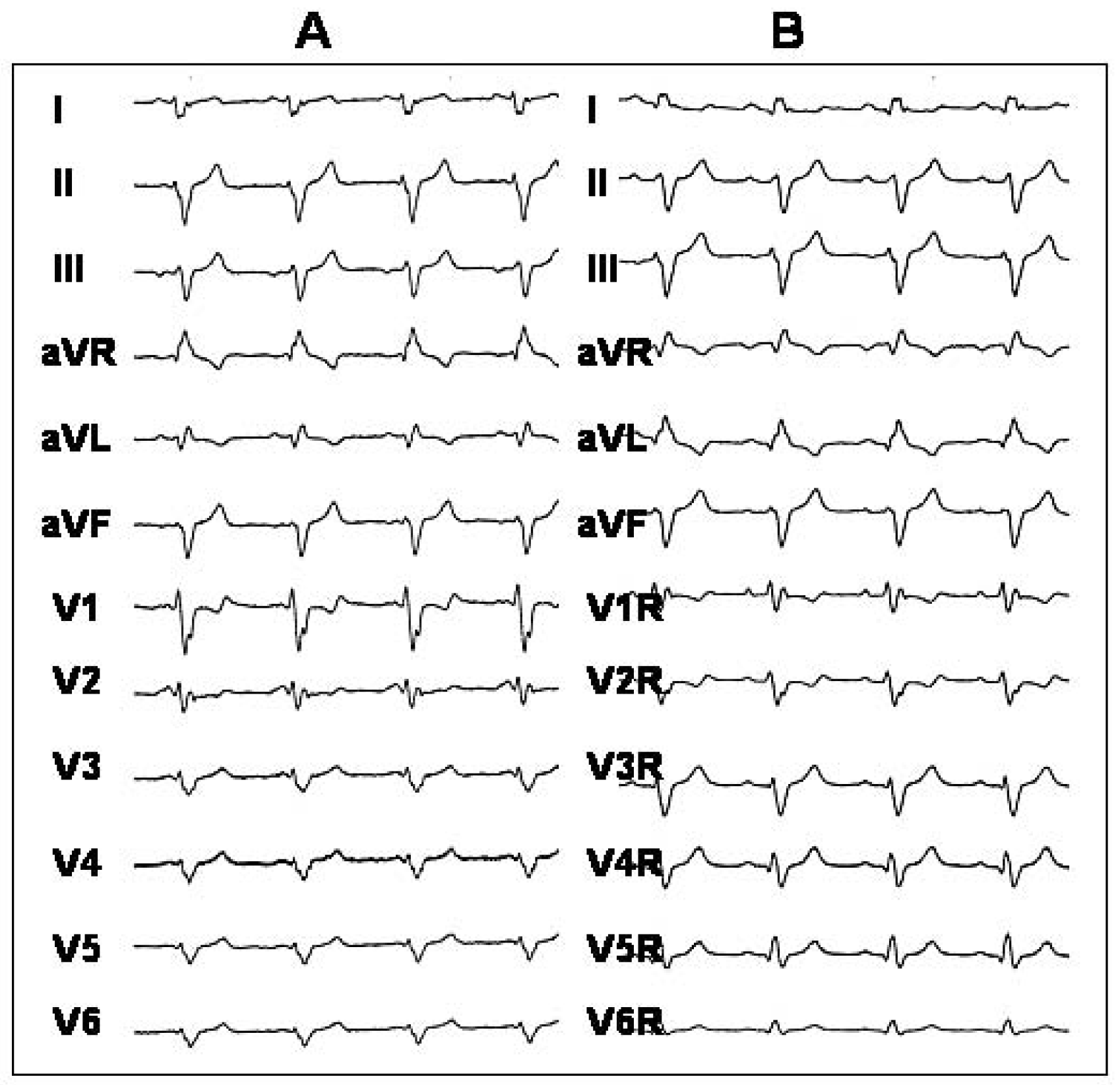 Radiofrequency Catheter Ablation of Atrioventricular Nodal Reentrant ...