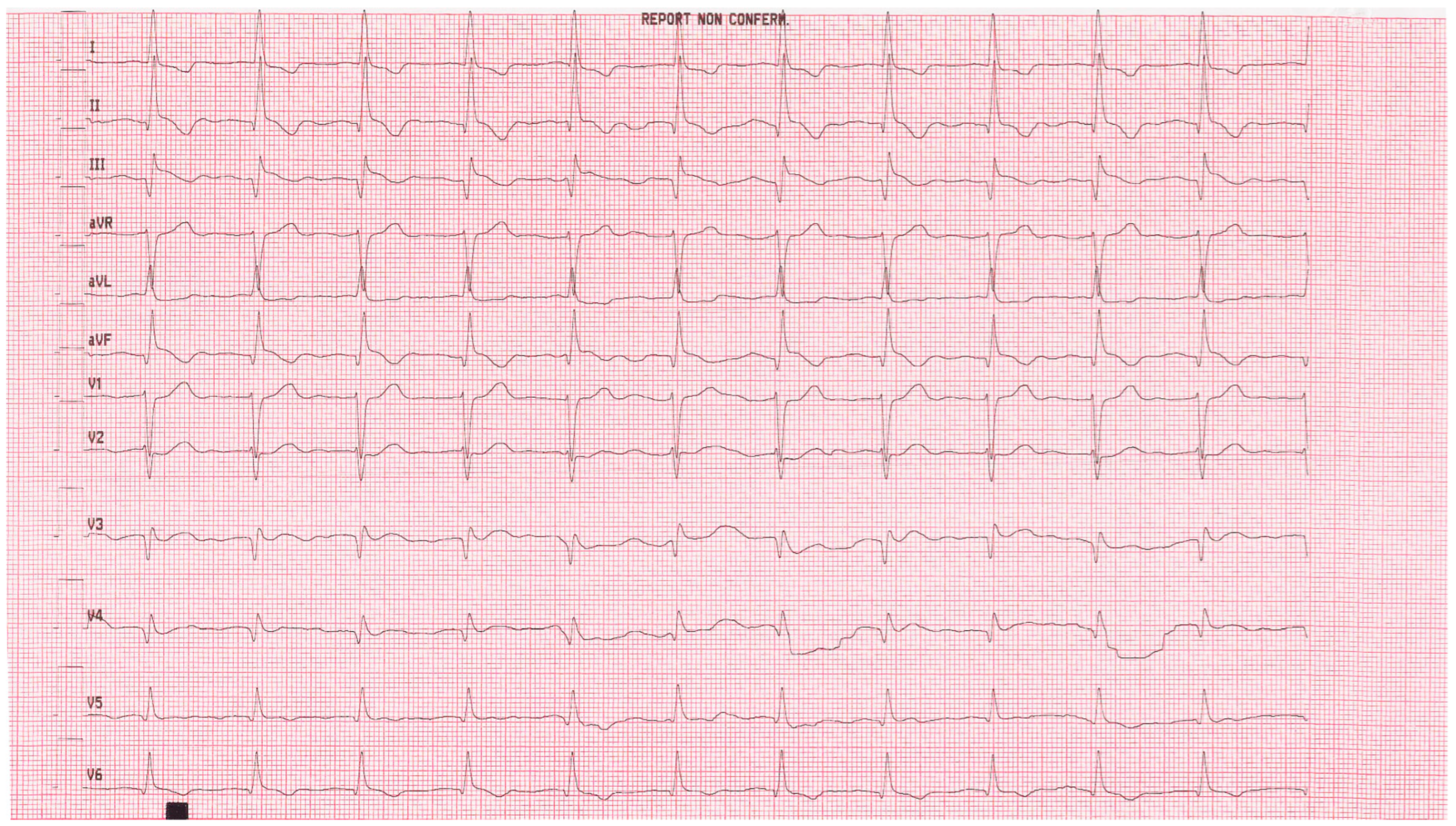The Heart Under Pressure: Transient ST-Segment Elevation Due to Severe ...
