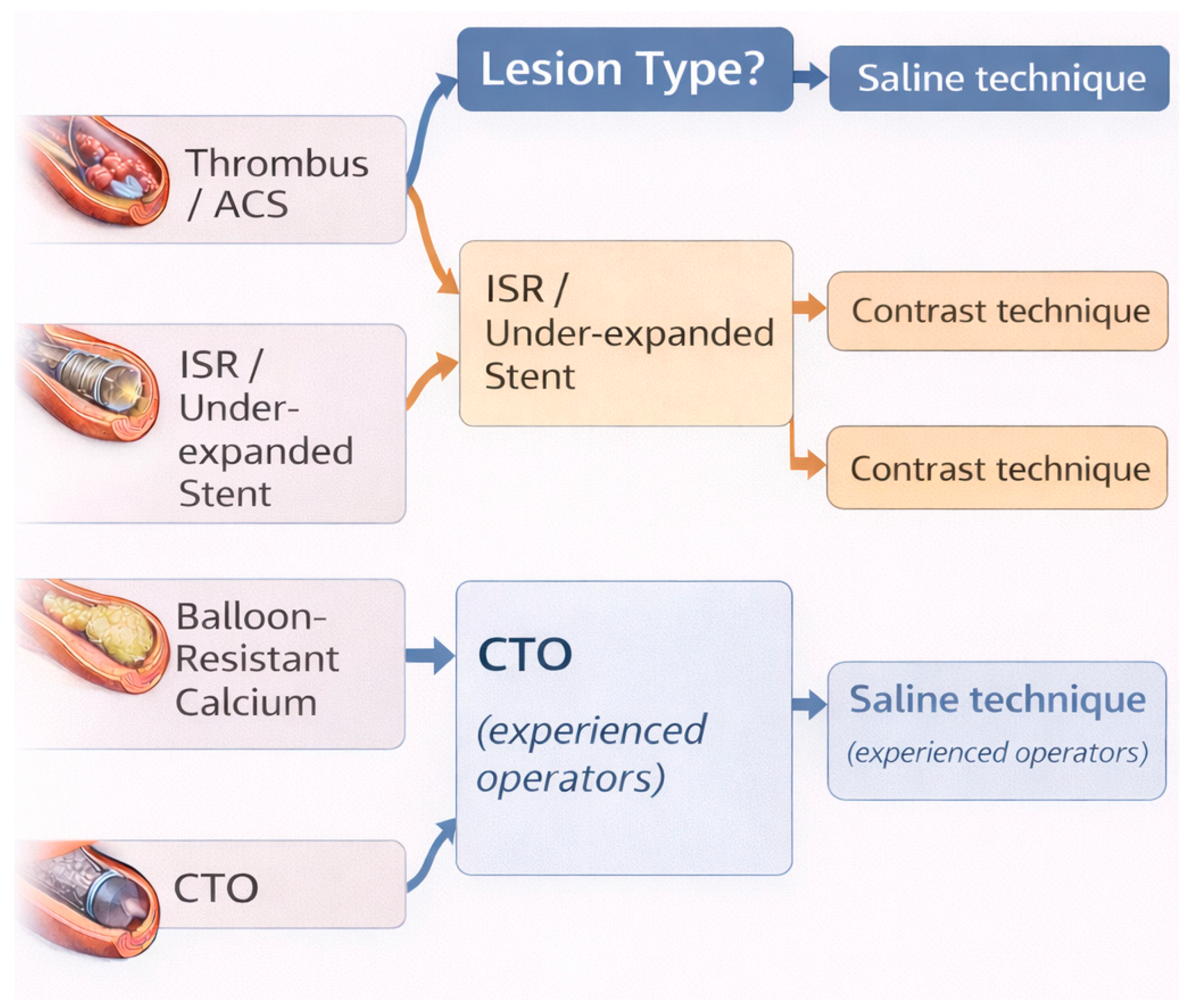 Excimer Laser Atherectomy: Mechanisms and Applications in Coronary and ...