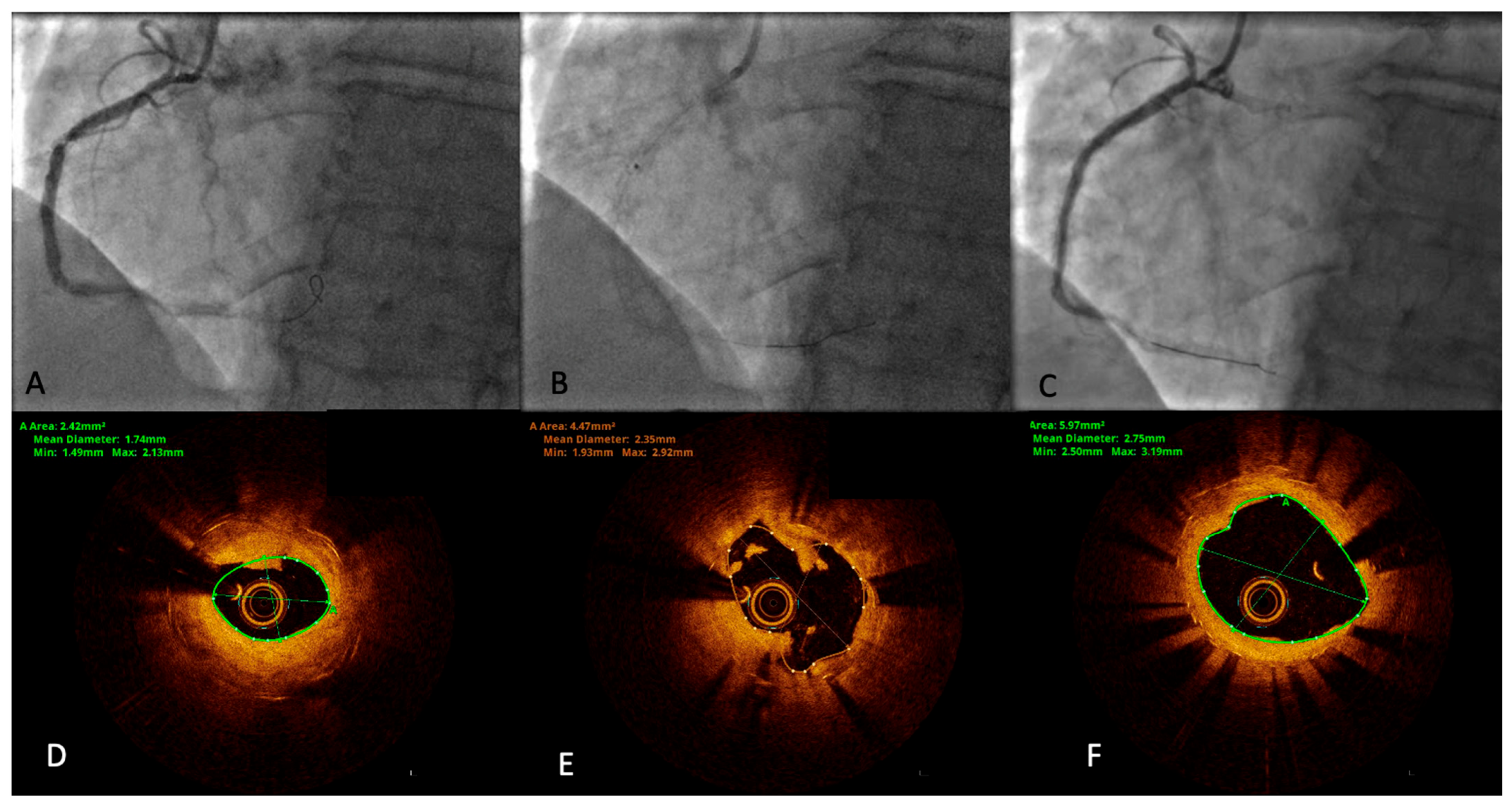 Excimer Laser Atherectomy: Mechanisms and Applications in Coronary and ...
