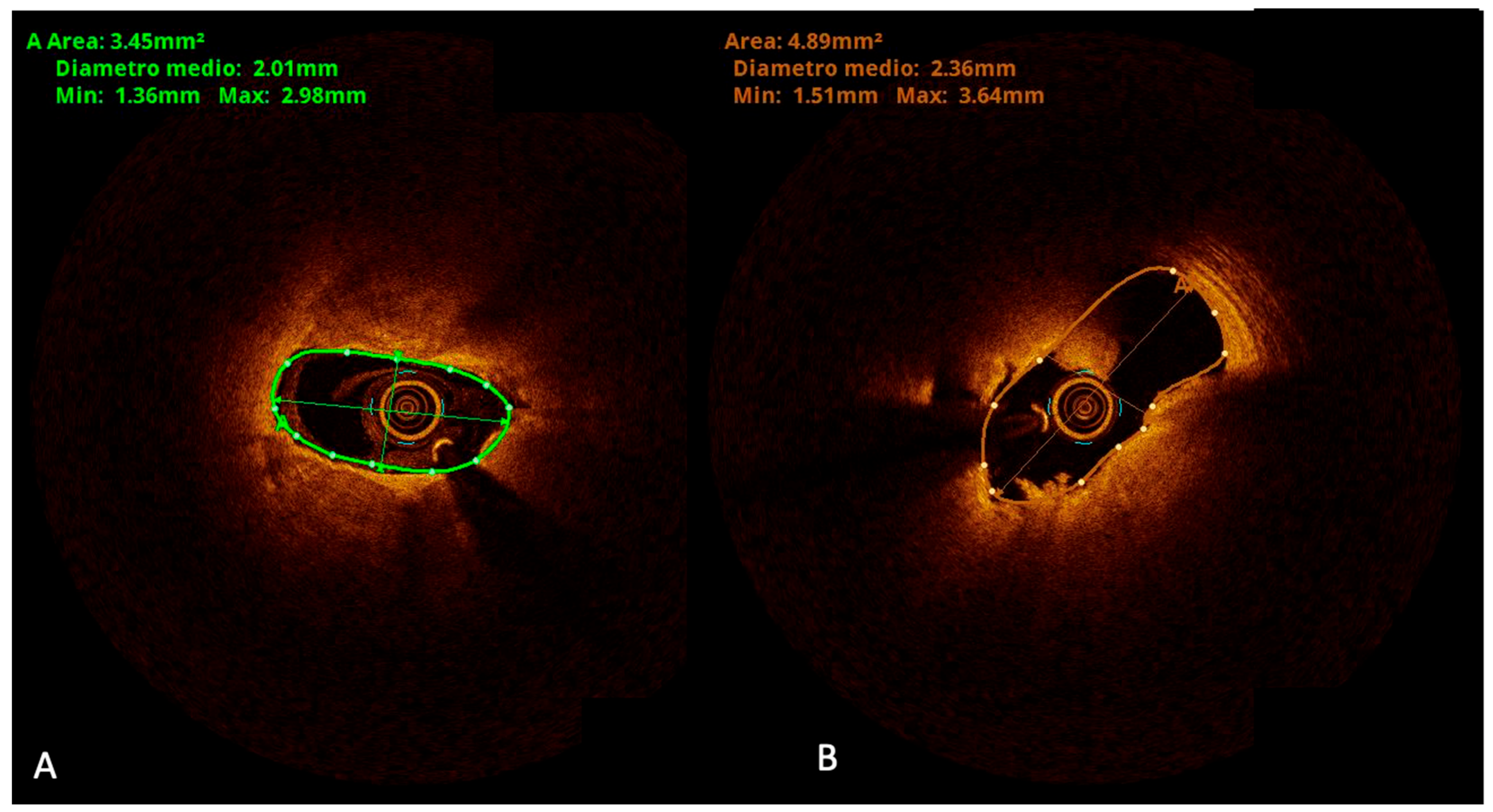 Excimer Laser Atherectomy: Mechanisms and Applications in Coronary and ...