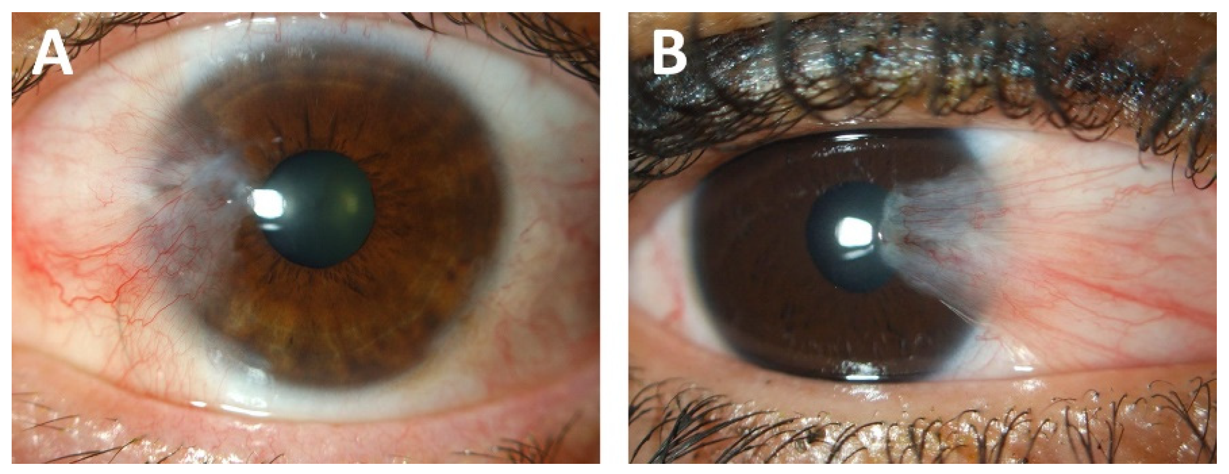 Pterygium Pterygium