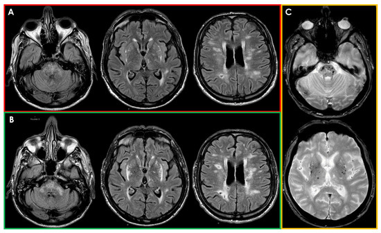 Cells | Free Full-Text | Expanding the Neurological Phenotype of ...