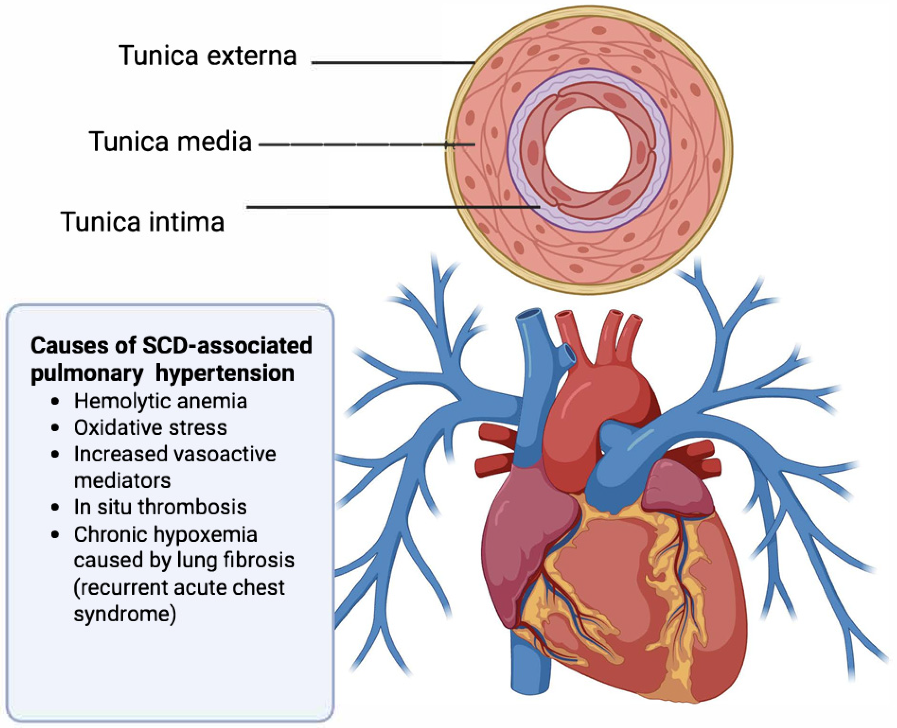 Rethinking Sickle Cell Disease as a Systemic Vasculopathy