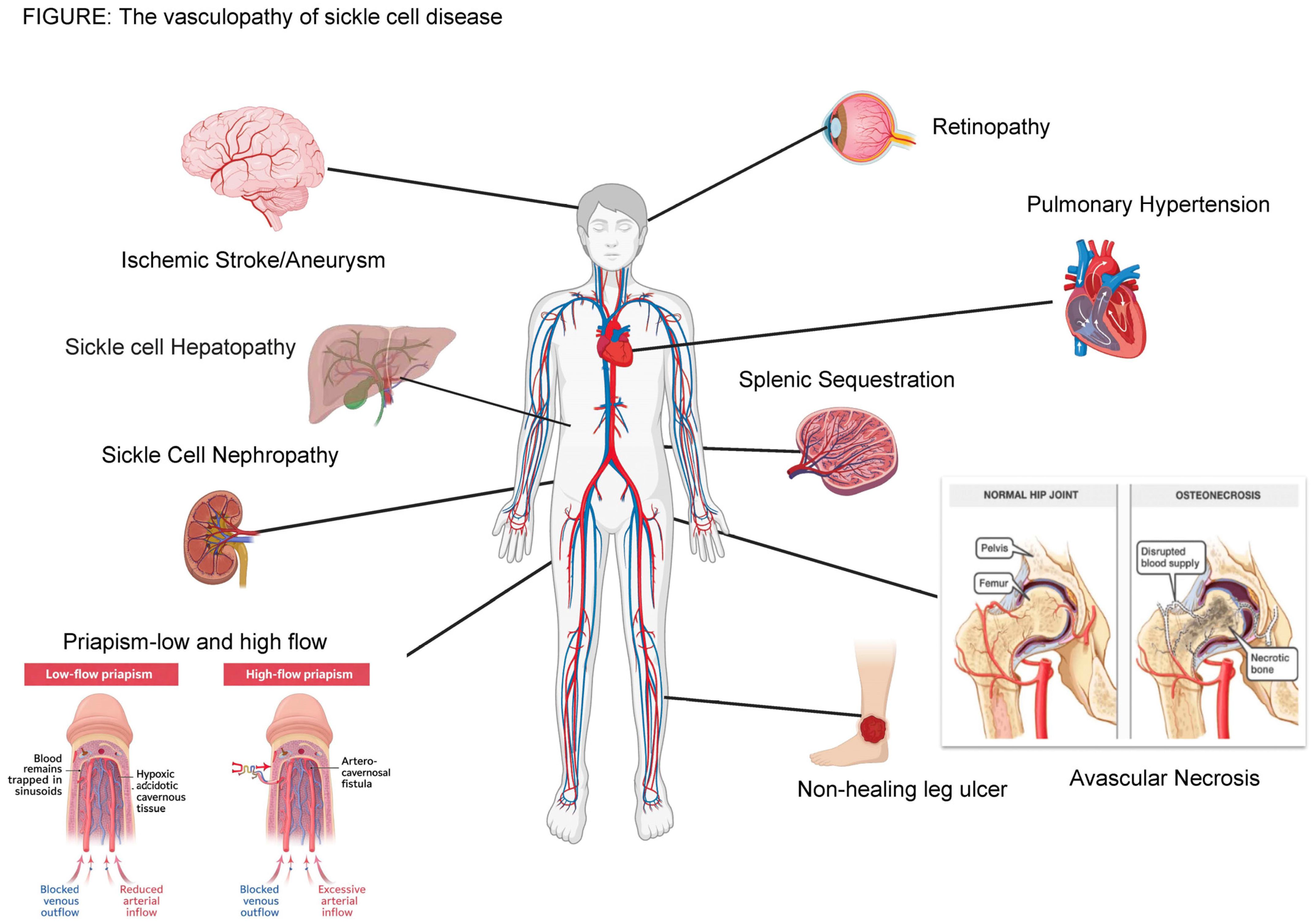 Rethinking Sickle Cell Disease as a Systemic Vasculopathy