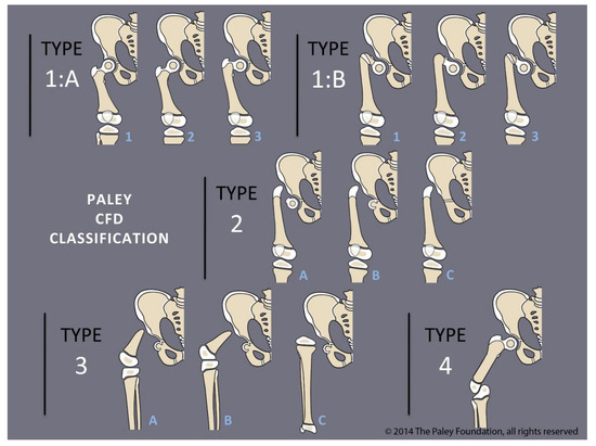 Children | Free Full-Text | Rotationplasty for Severe Congenital ...