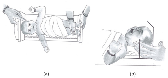Anthropometric and Physiologic Parameters in Cleft Neonates: A Hospital ...