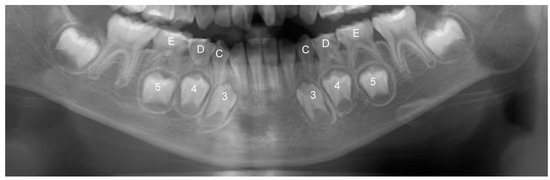 Effects of Gender and Age in Mandibular Leeway Space for Taiwanese Children