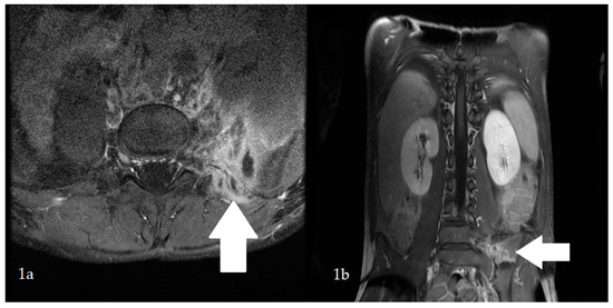 A Severe Systemic Infection in a 14-Year-Old Boy That Took Place during ...