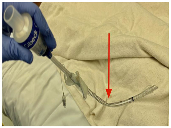 Endotracheal Tube Kinking in the Prone Position during Pediatric ...