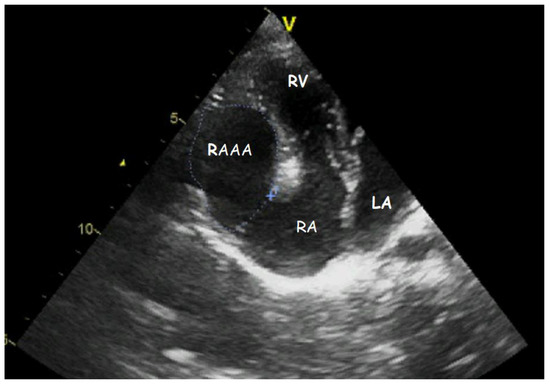 A Gigantic Congenital Right Atrial Appendage Aneurysm in an Infant: Ten ...