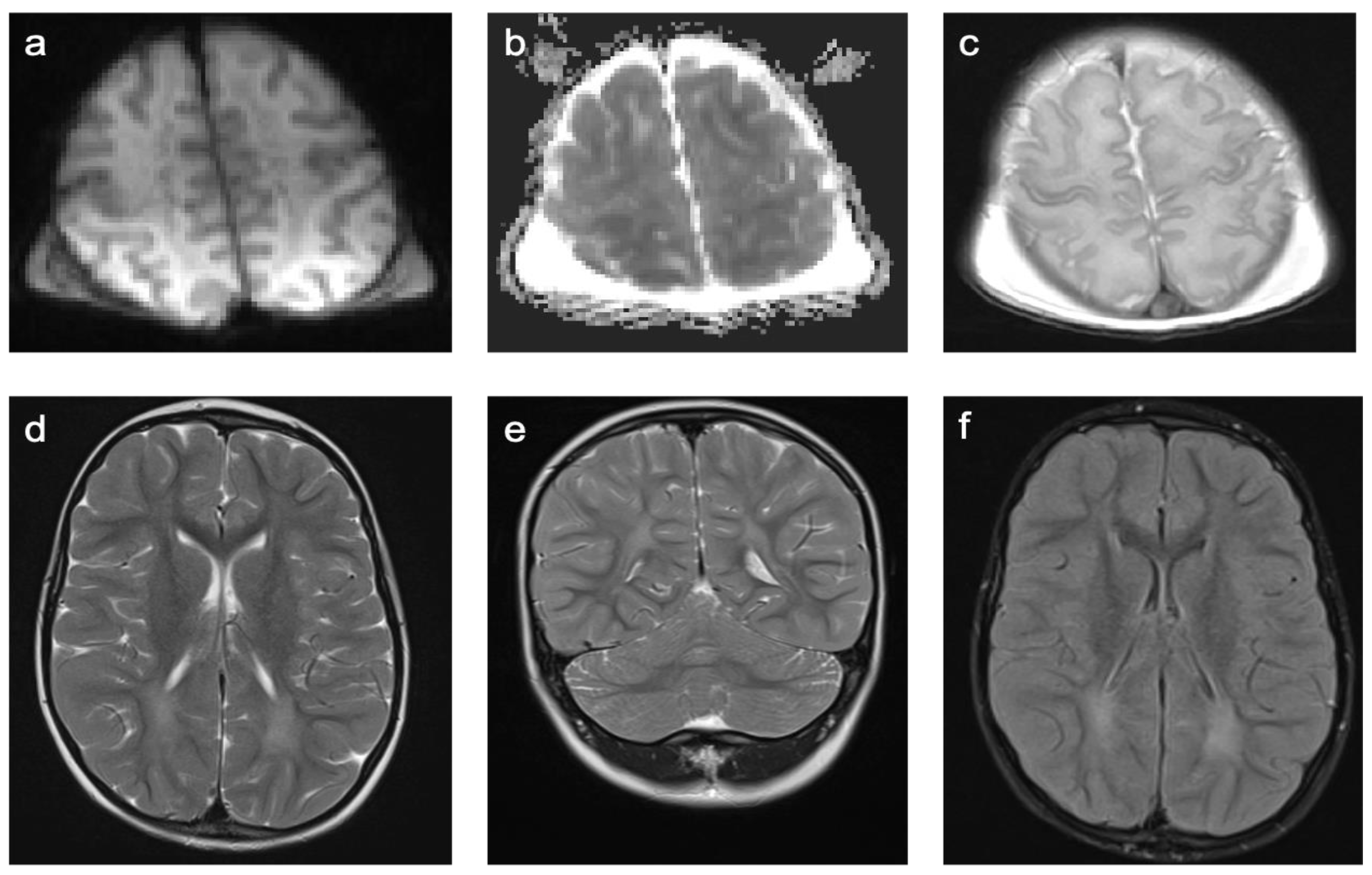 Children Free Full Text Characterization Of MRI White Matter Signal Children Free Full Text Characterization Of MRI White Matter Signal