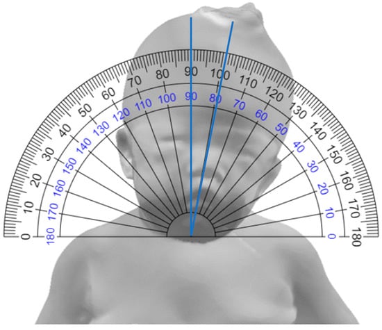 Quantitative Analysis of the Head Tilt Using Three-Dimensional Temporal ...