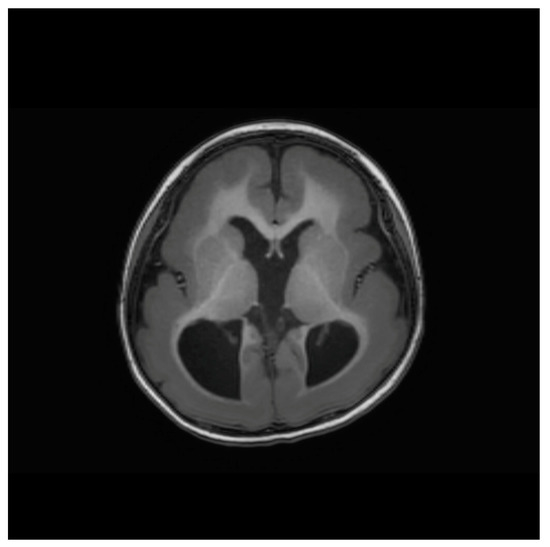 Anesthetic Management and Bispectral Index in a Child with Miller ...