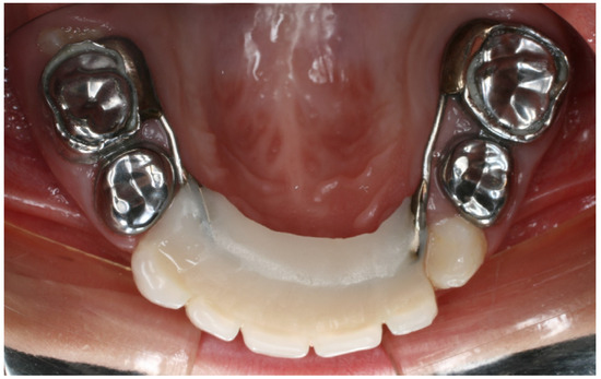 Longevity of Aesthetic Fixed Space Maintainers in the Anterior Area of ...