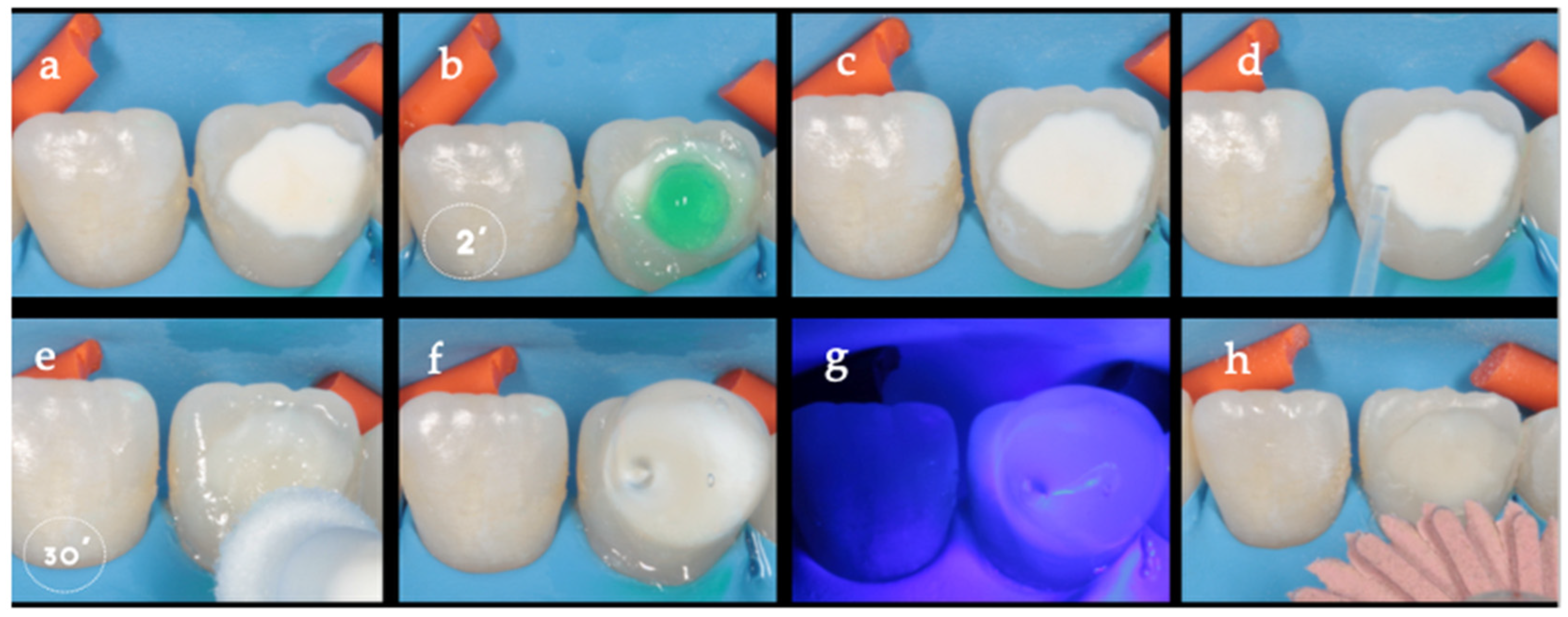Resin Infiltration for Anterior Teeth Affected by Molar Incisor ...