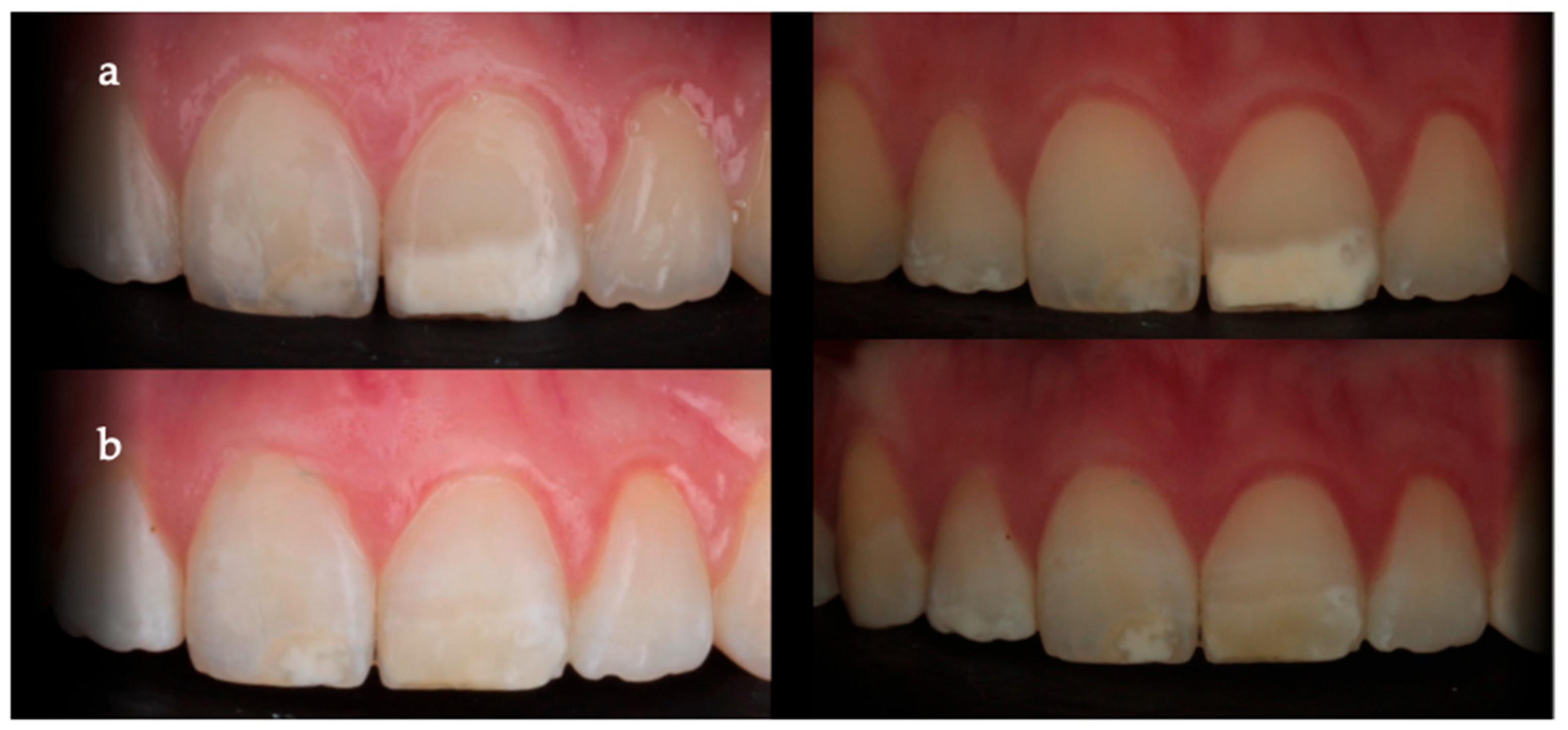 Resin Infiltration for Anterior Teeth Affected by Molar Incisor ...