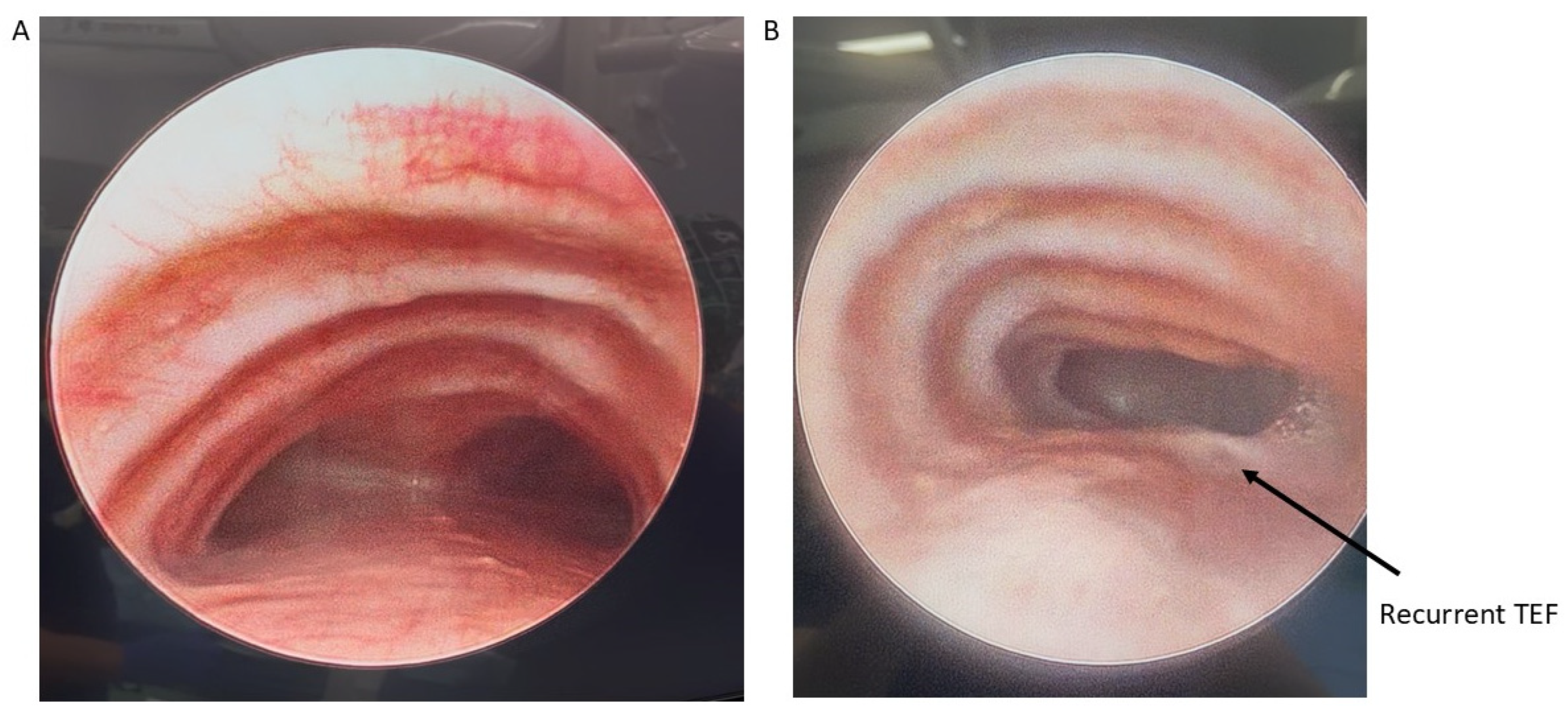 Indications and Utility of Posterior Tracheopexy in the Pediatric ...