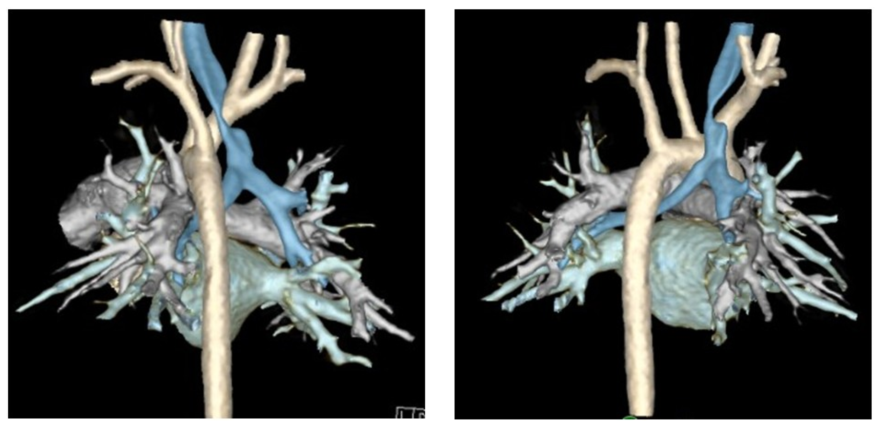 Indications and Utility of Posterior Tracheopexy in the Pediatric ...