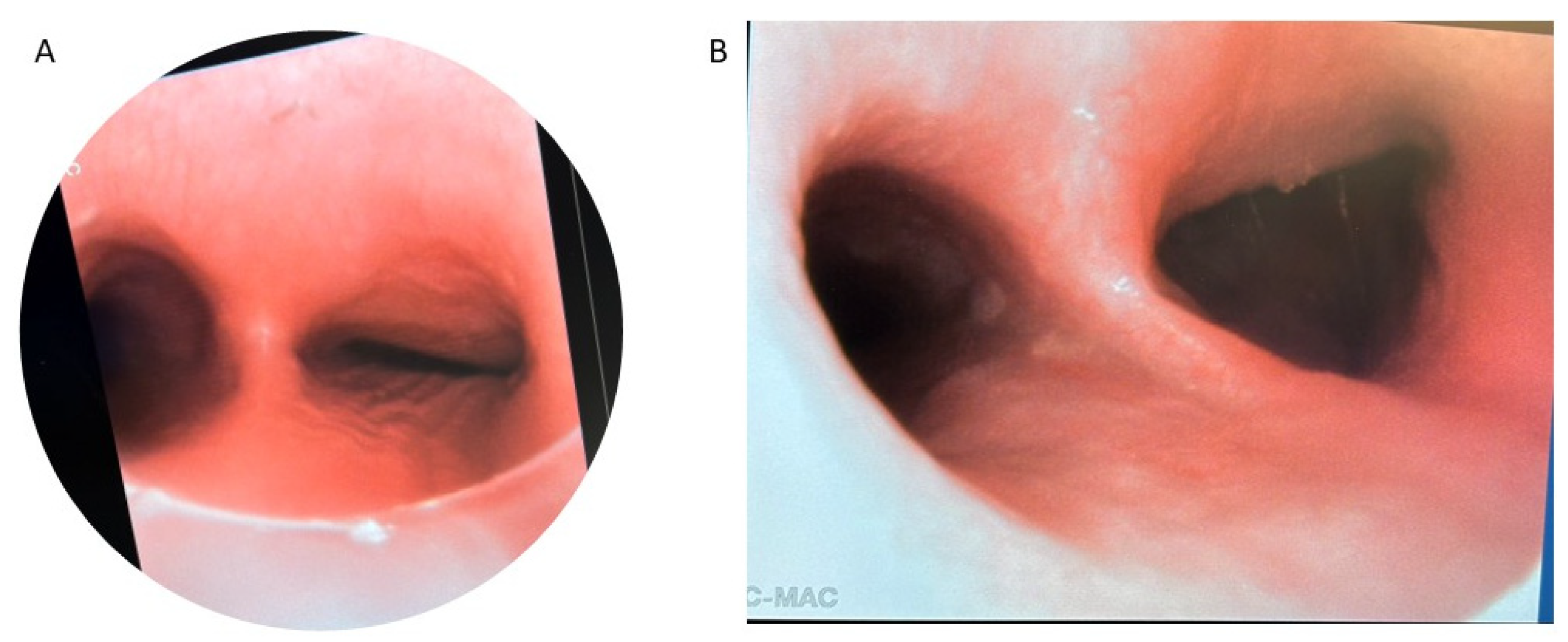 Indications and Utility of Posterior Tracheopexy in the Pediatric ...