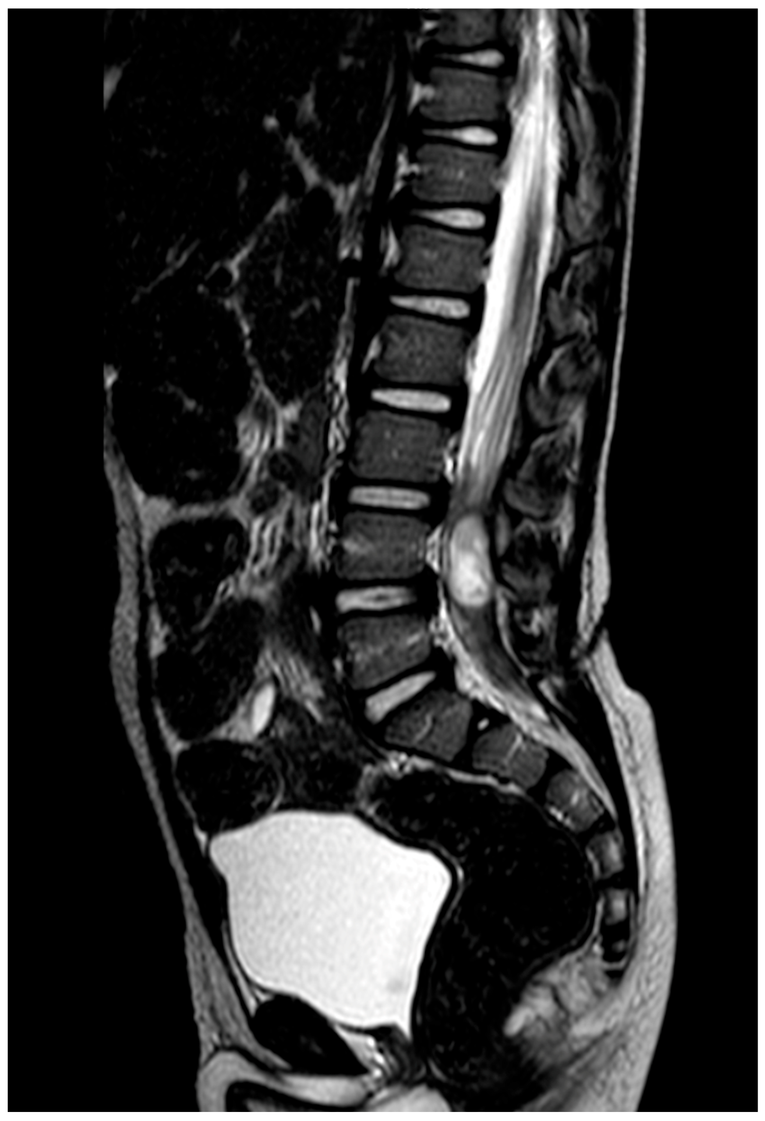 Surgical Treatment of Tethered Cord Syndrome by Release of Filum ...