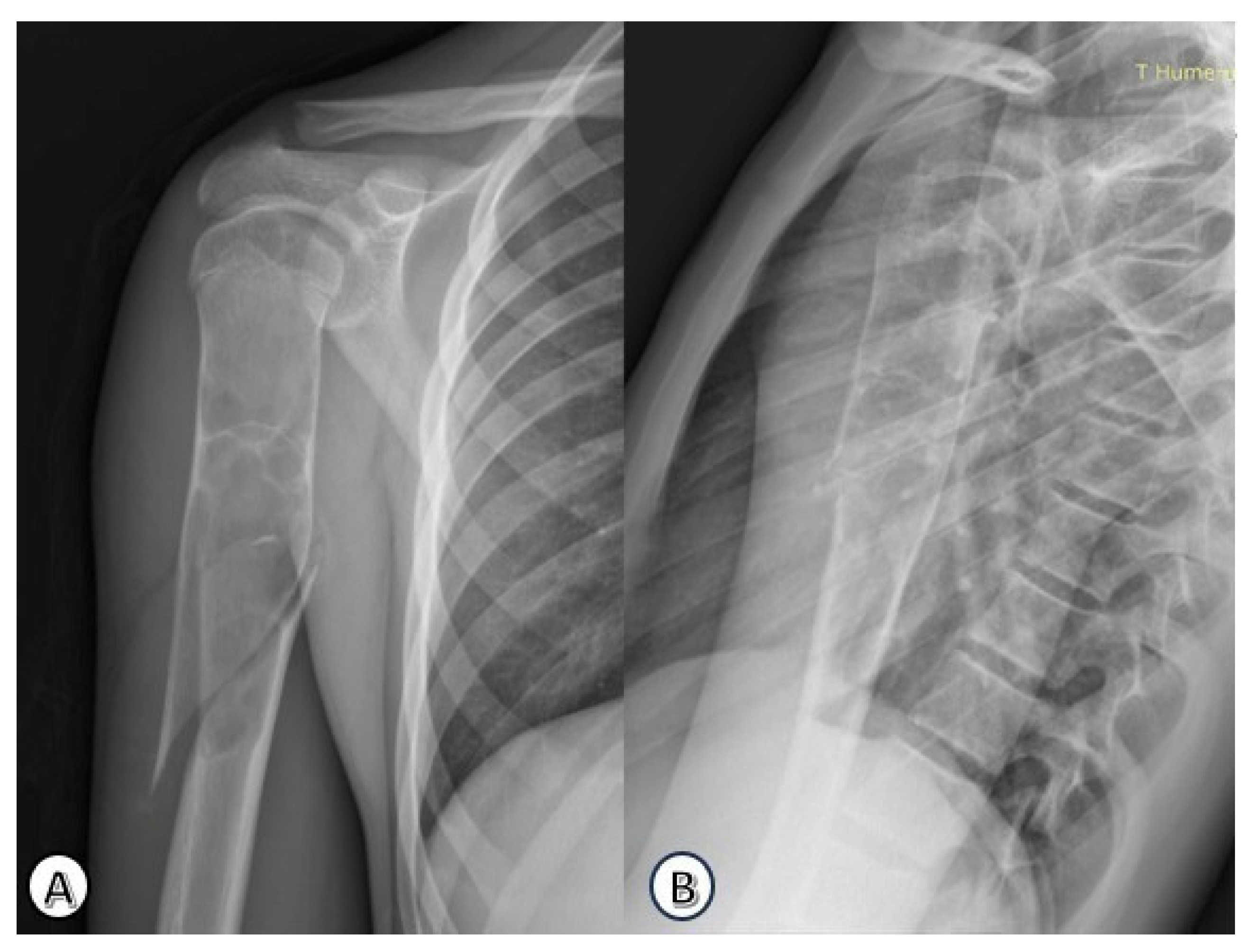 Management of Humeral Solitary Bone Cysts in Children Using Elastic ...