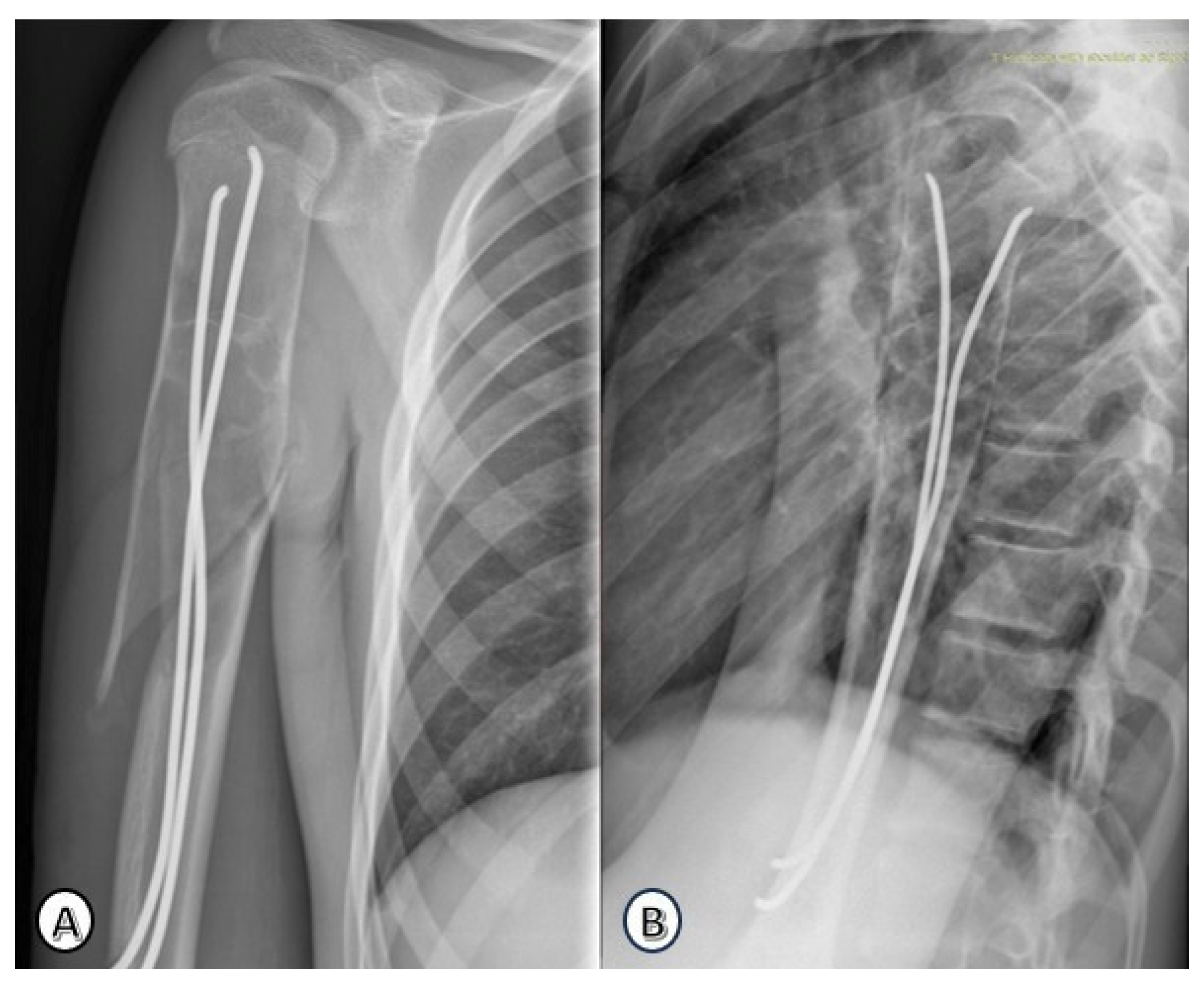 Management of Humeral Solitary Bone Cysts in Children Using Elastic ...