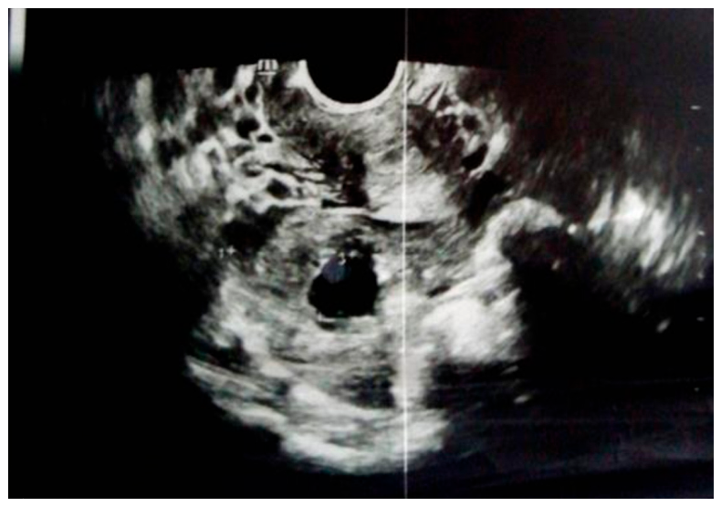 Rare Implantation Sites of Ectopic Pregnancy: A Case Series of Ovarian ...