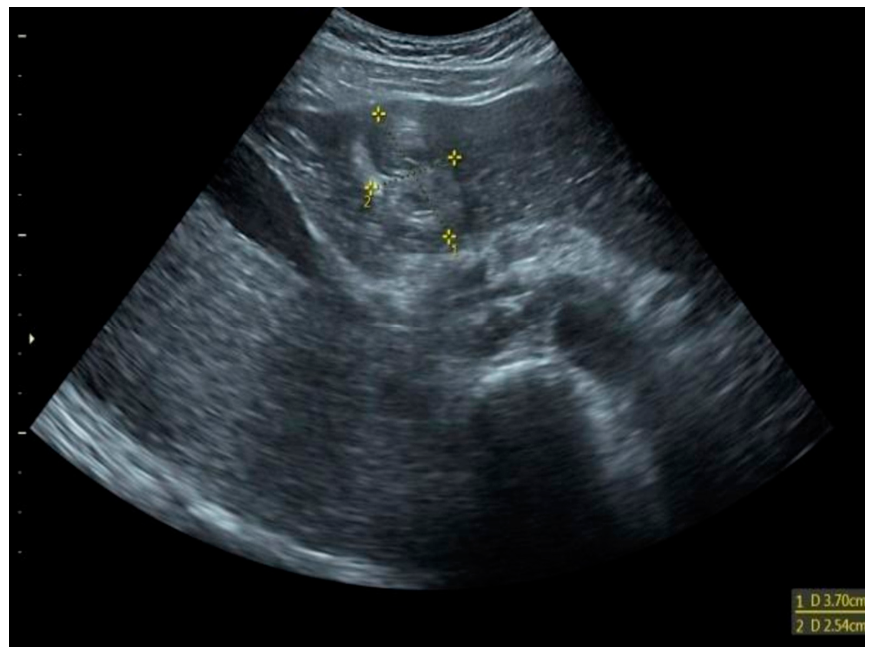 Rare Implantation Sites of Ectopic Pregnancy: A Case Series of Ovarian ...