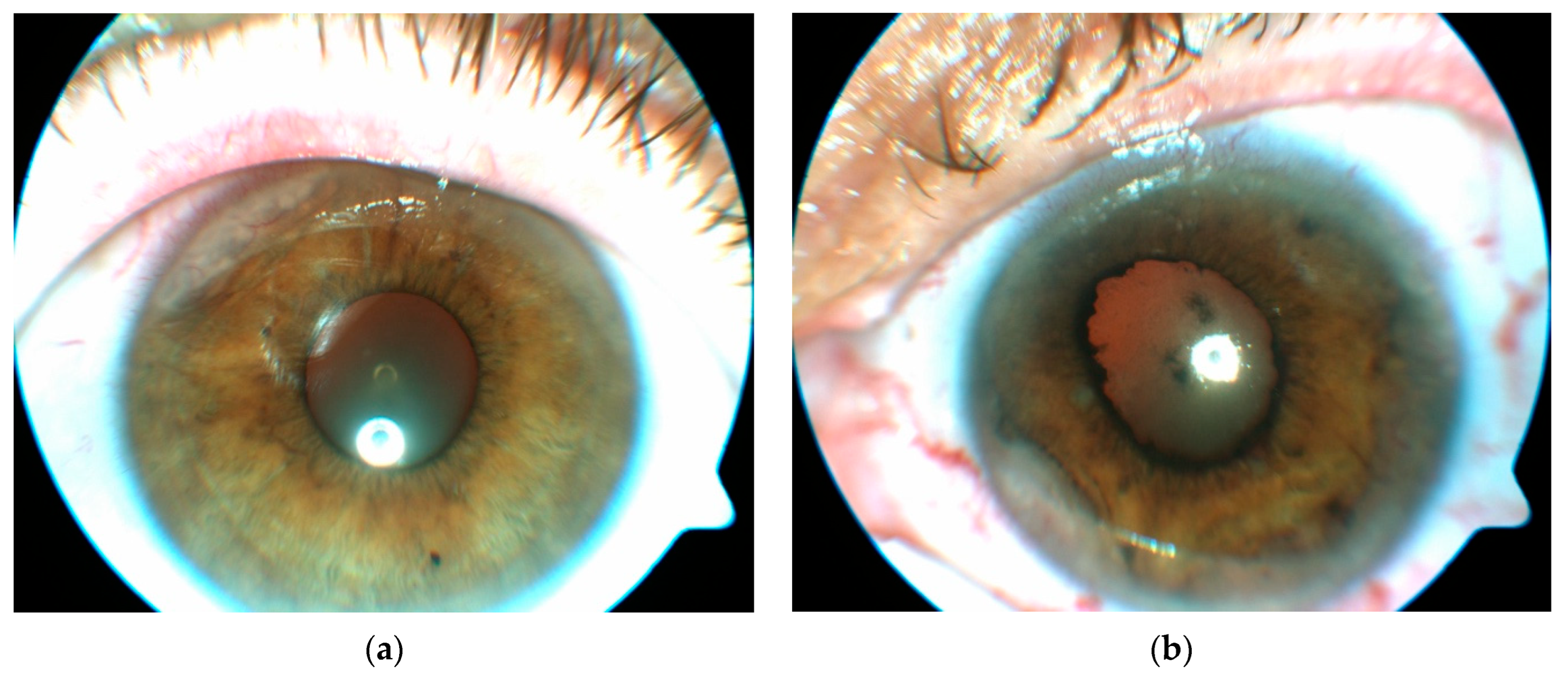 Bilateral Iris Metastasis of Small Cell Lung Carcinoma: A Case Report ...