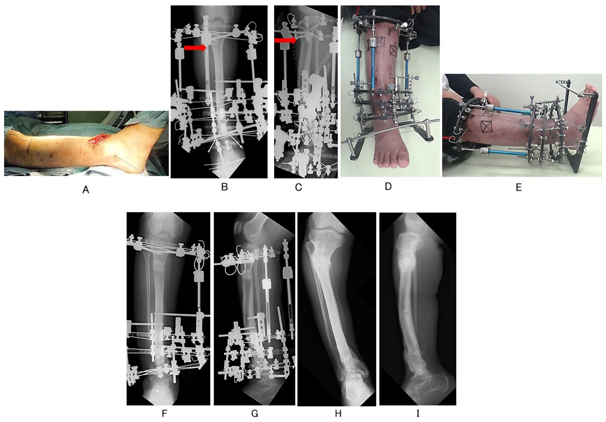 Limb Salvage After Chronic Nonunion Following Deformity Correction in ...