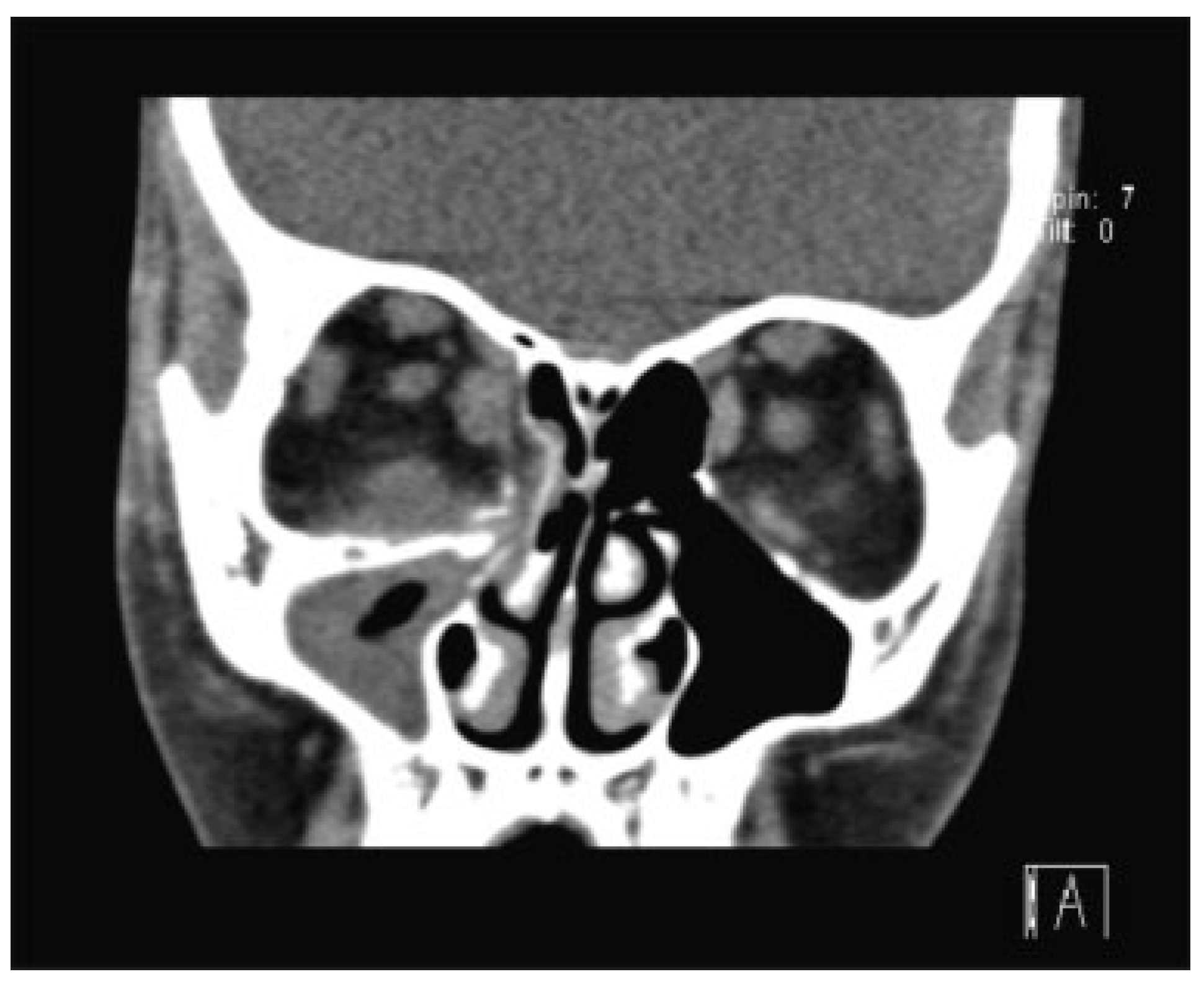 Secondary Infection Affecting One of Two Simultaneously Placed Orbital ...