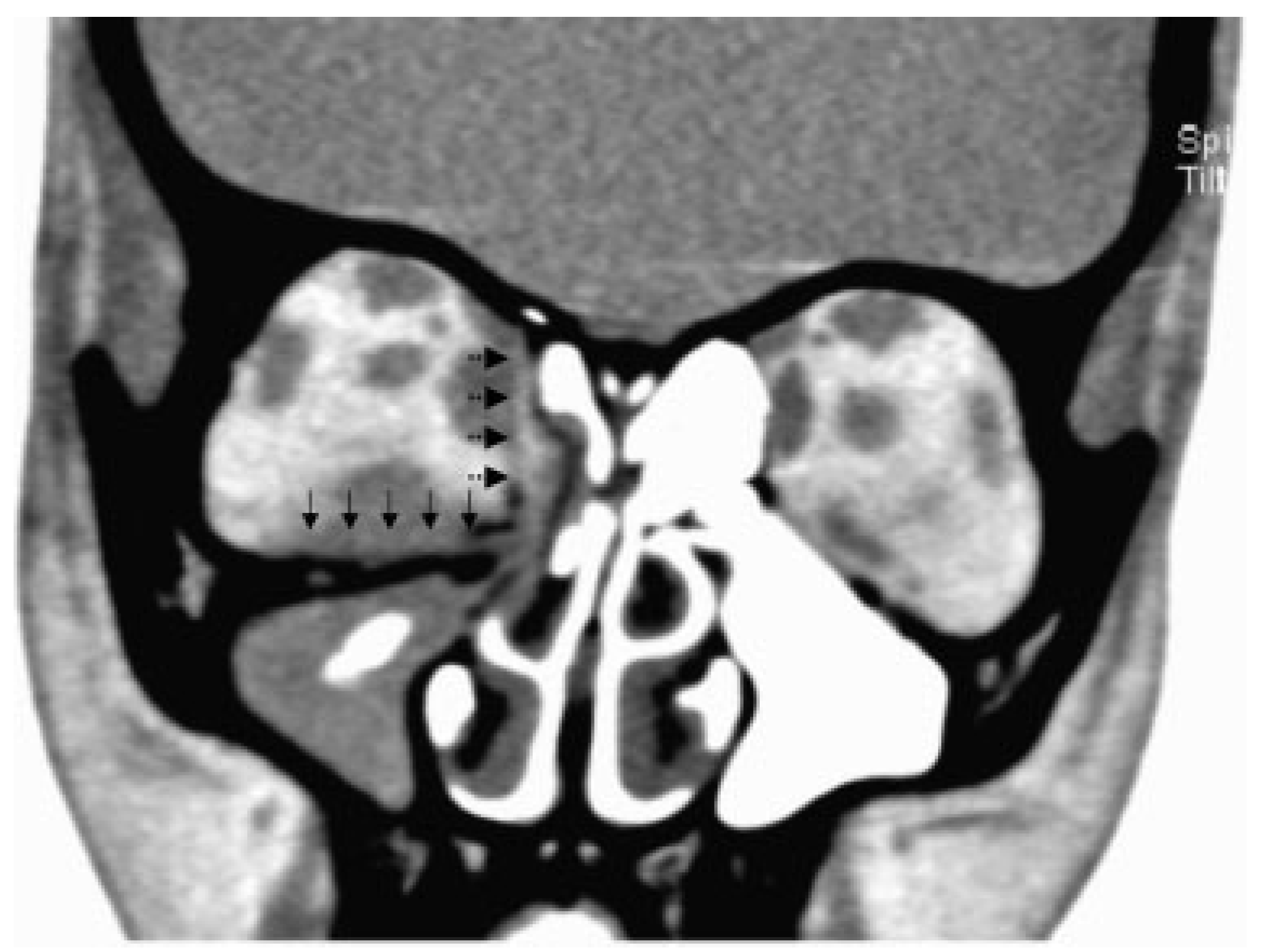 Secondary Infection Affecting One of Two Simultaneously Placed Orbital ...