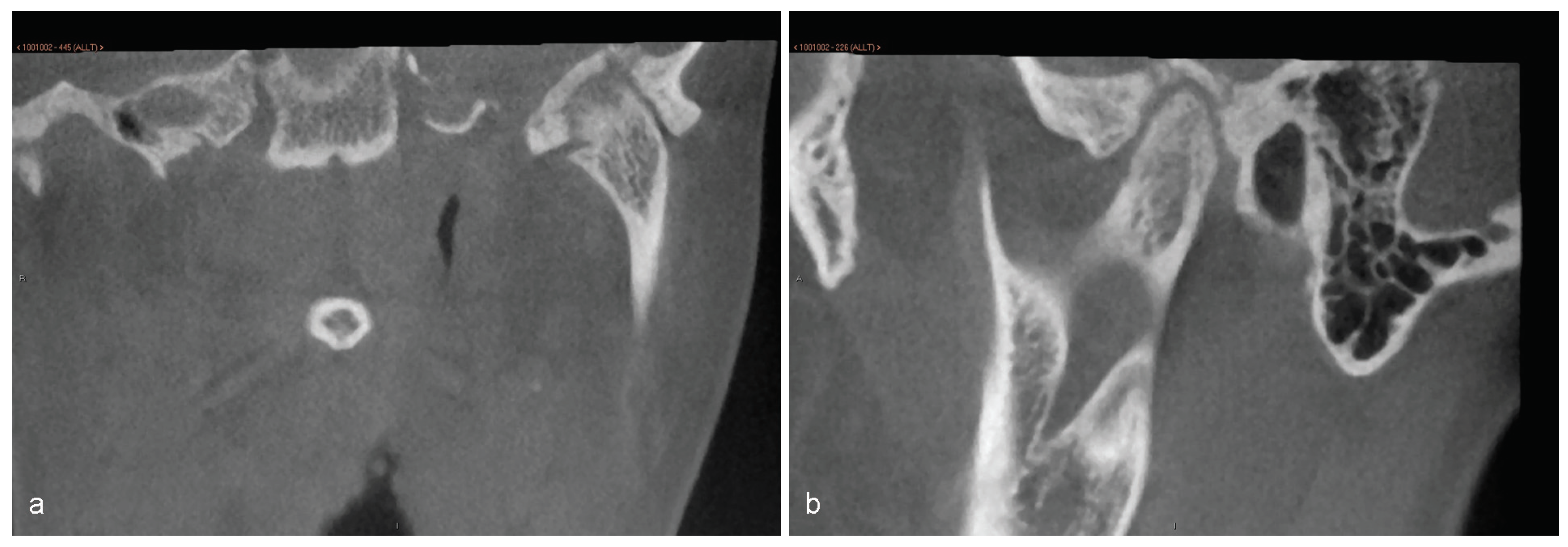 A Case of Glenoid Fossa Fracture, Progressive Ankylosis, Total Joint ...
