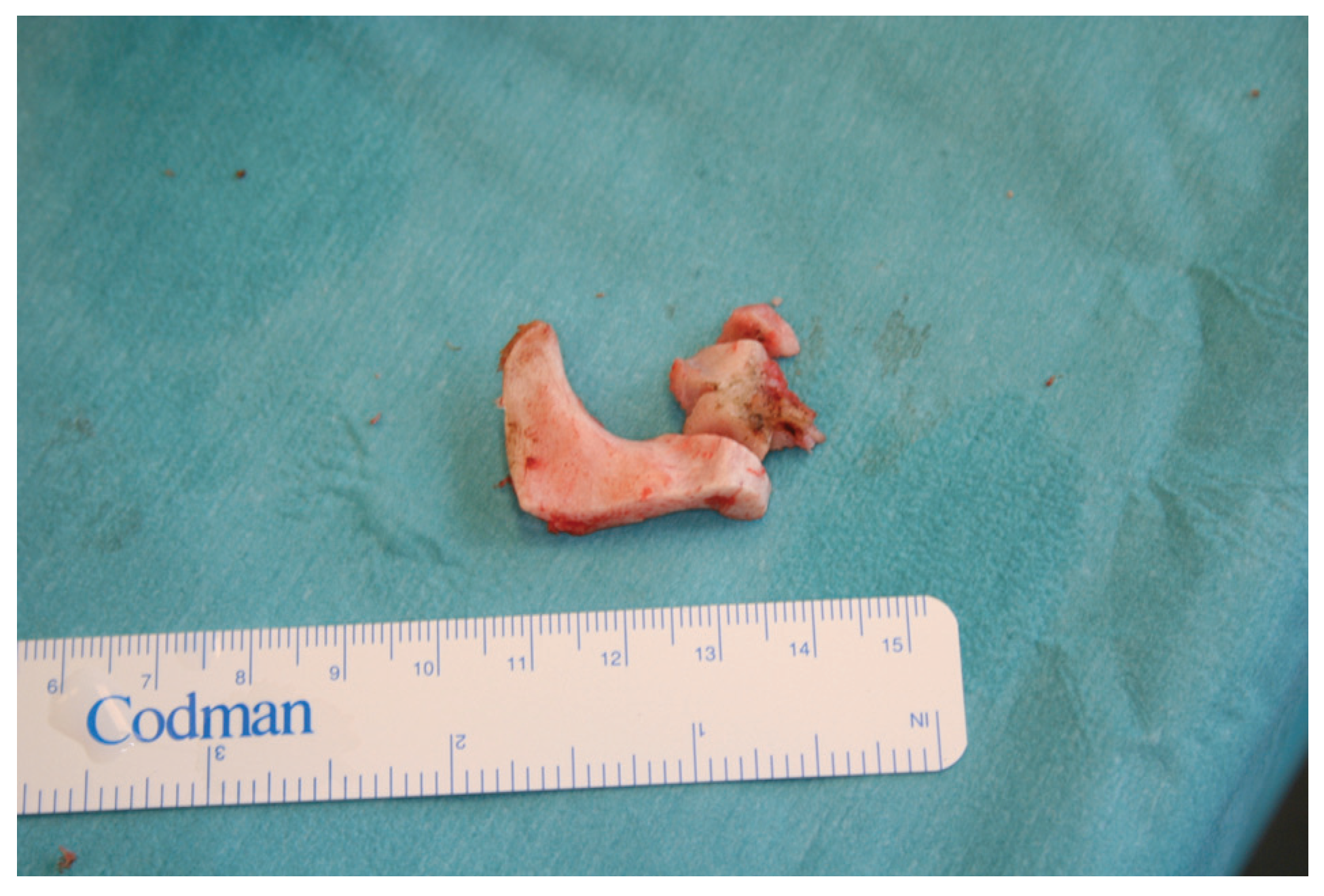 A Case of Glenoid Fossa Fracture, Progressive Ankylosis, Total Joint ...