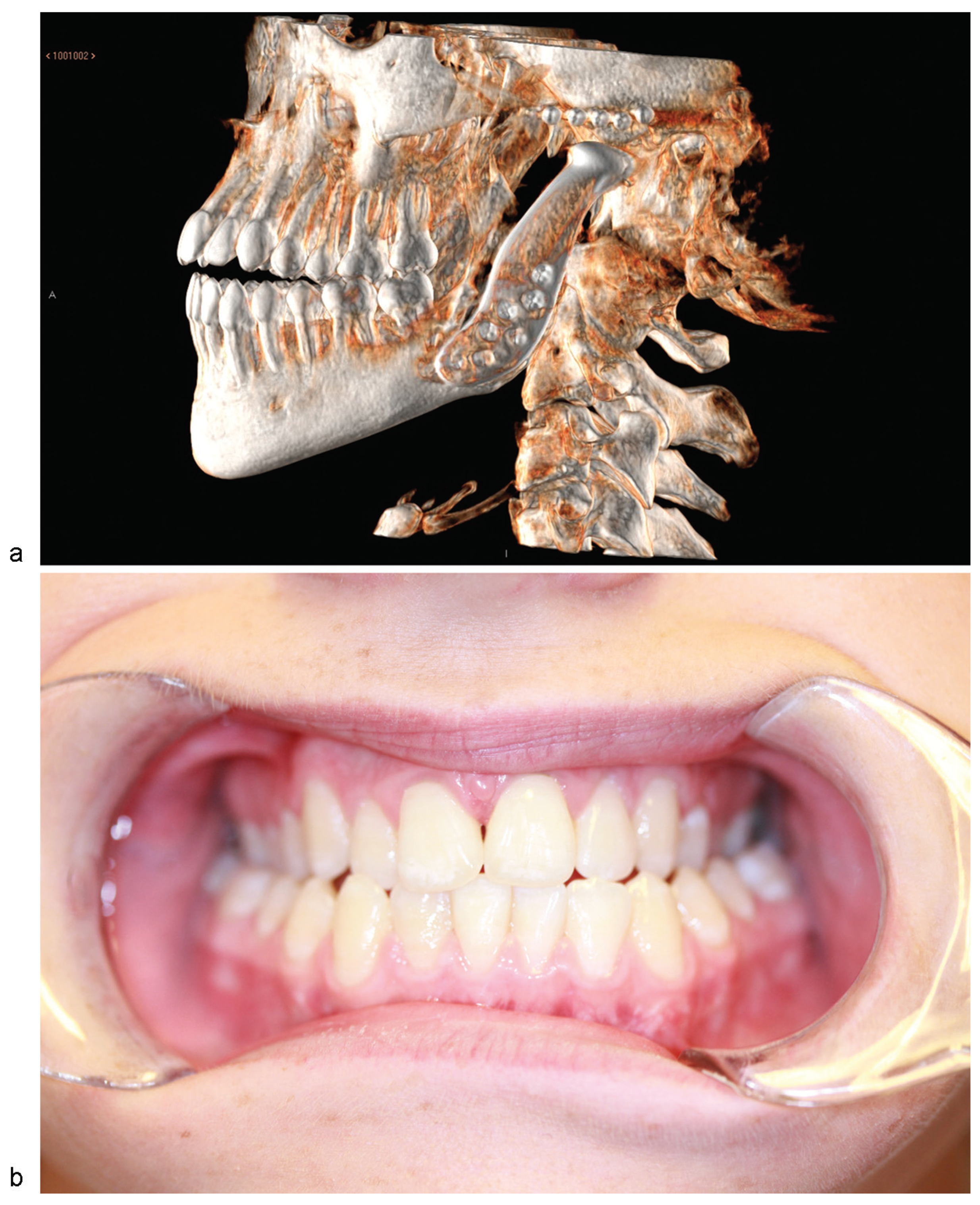 A Case of Glenoid Fossa Fracture, Progressive Ankylosis, Total Joint ...