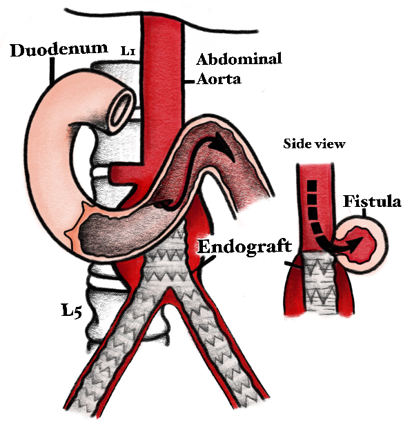 Aortic Endograft Infections: A Race against Time