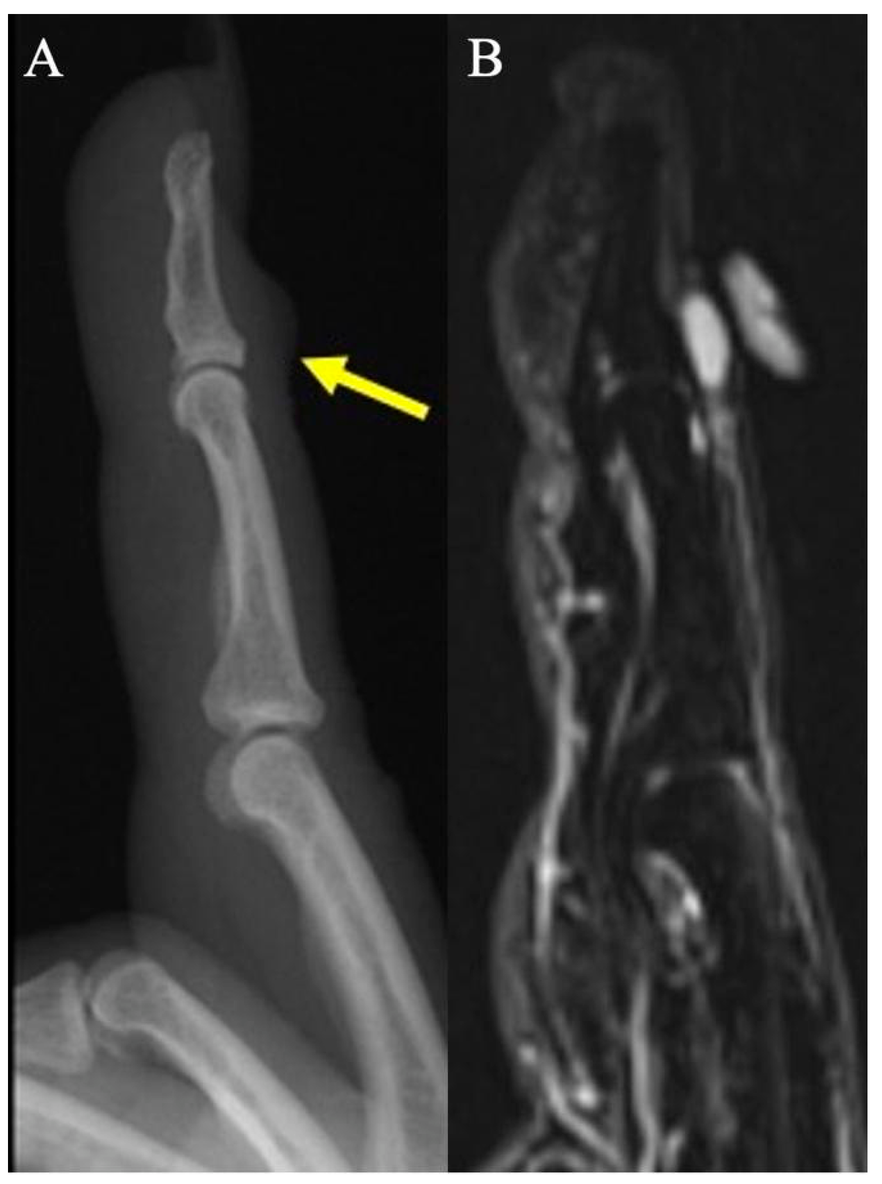 Current Oncology Free Full Text Soft Tissue Masses Of The Hand A Current Oncology Free Full Text Soft Tissue Masses Of The Hand A