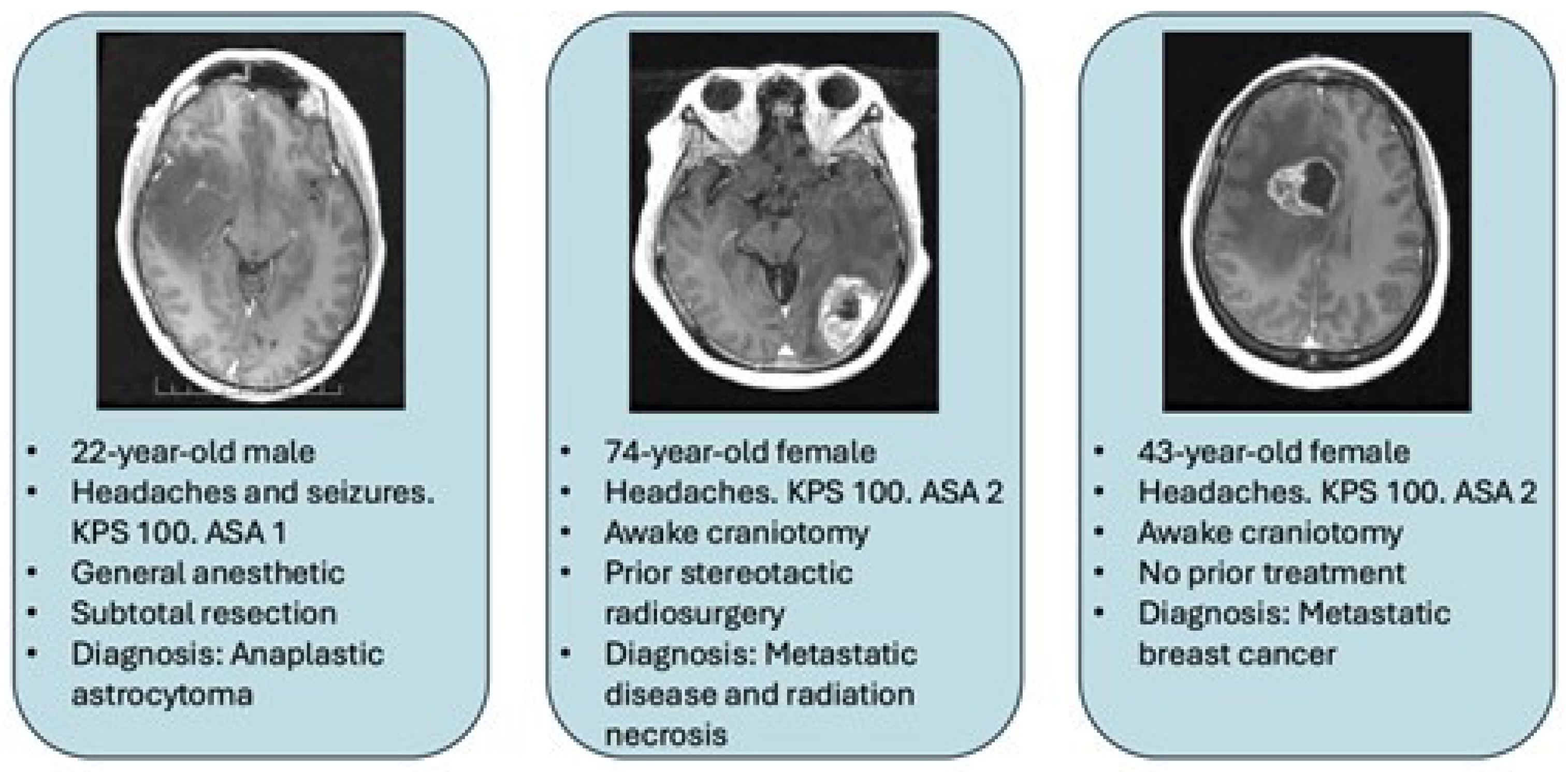Outpatient Surgery in Neuro-Oncology—Advancing Patient Access and Care