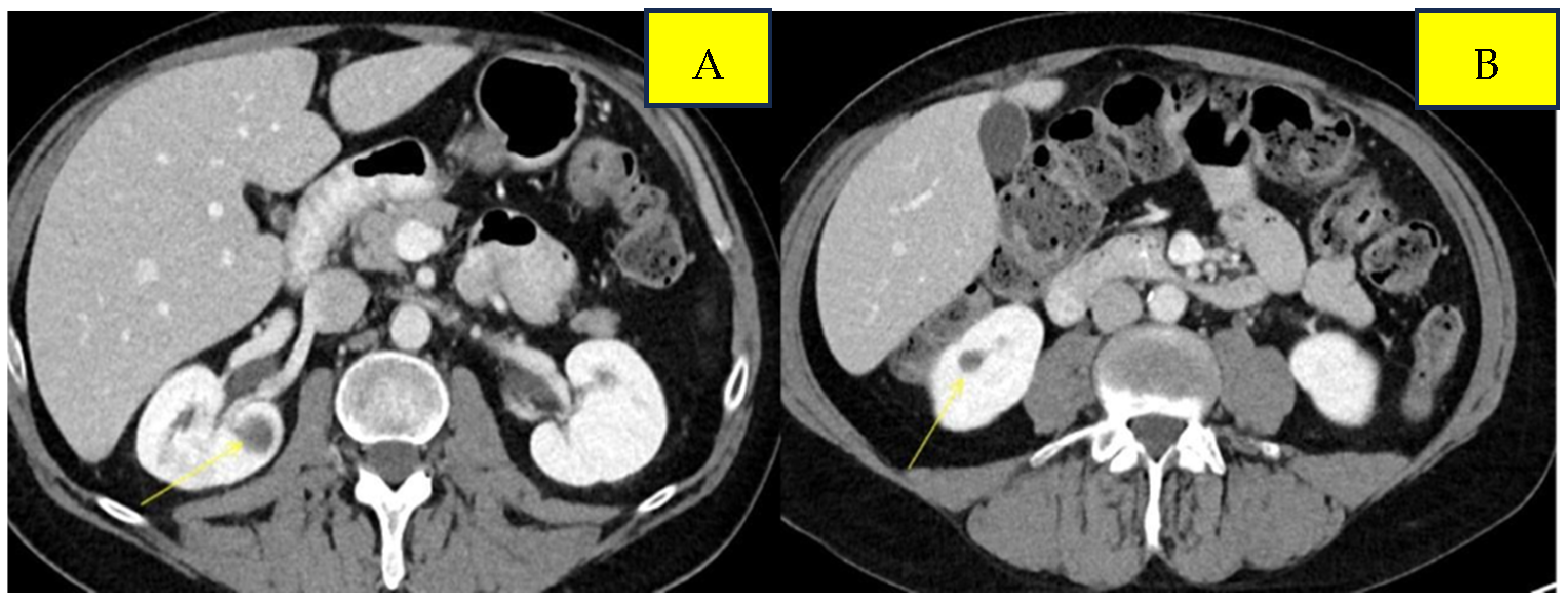 Anal Squamous Cell Carcinoma with Bilateral Renal Metastases: A Rare ...