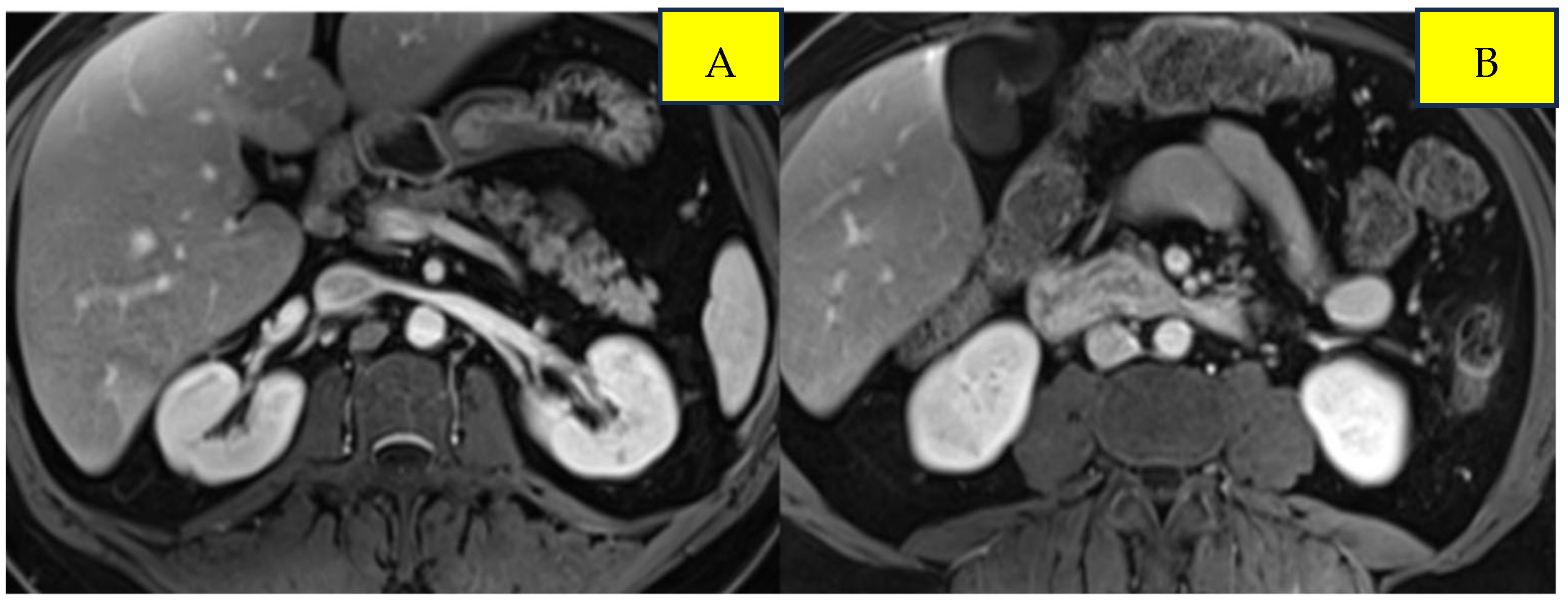 Anal Squamous Cell Carcinoma with Bilateral Renal Metastases: A Rare ...