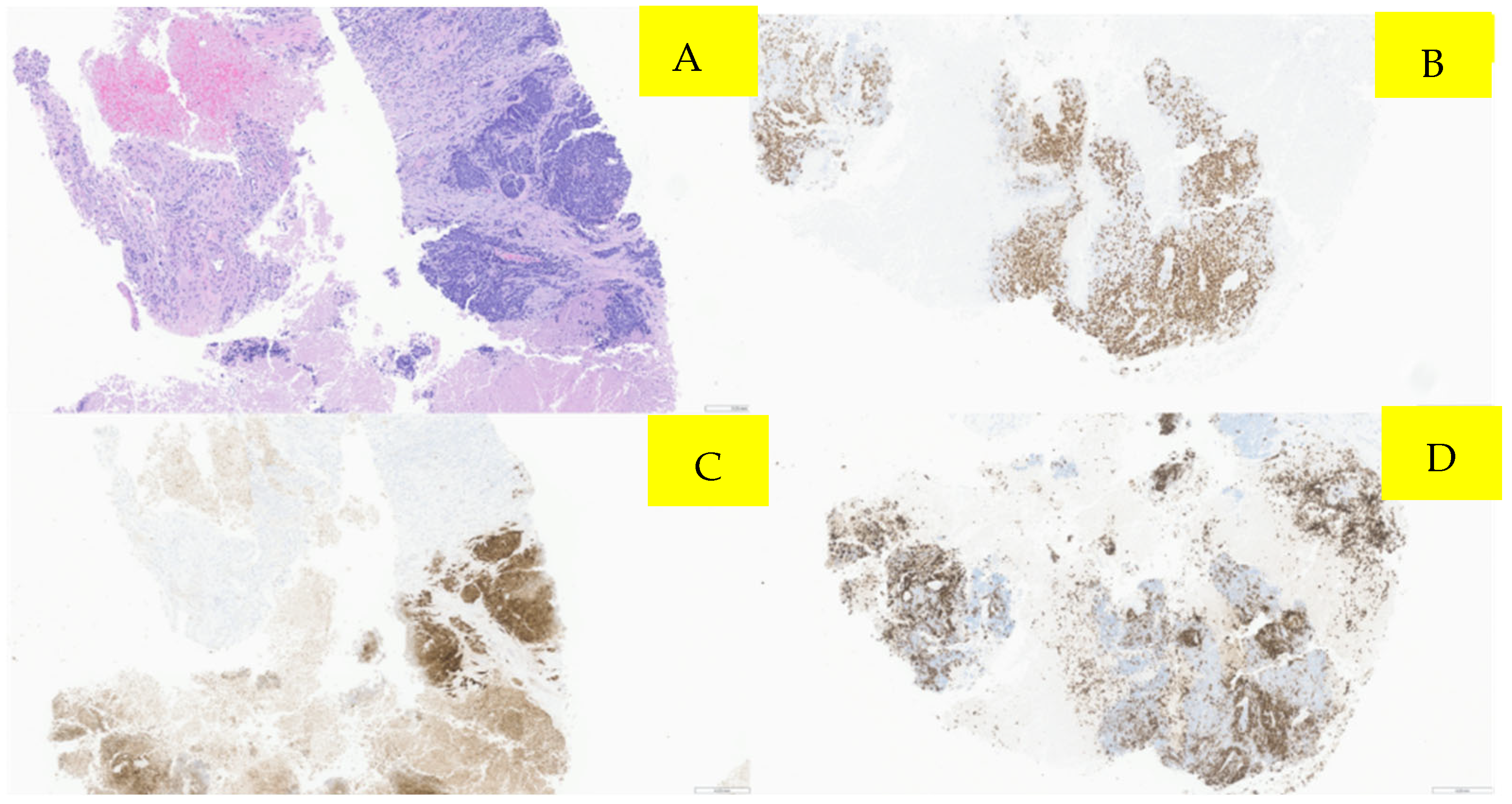 Anal Squamous Cell Carcinoma with Bilateral Renal Metastases: A Rare ...