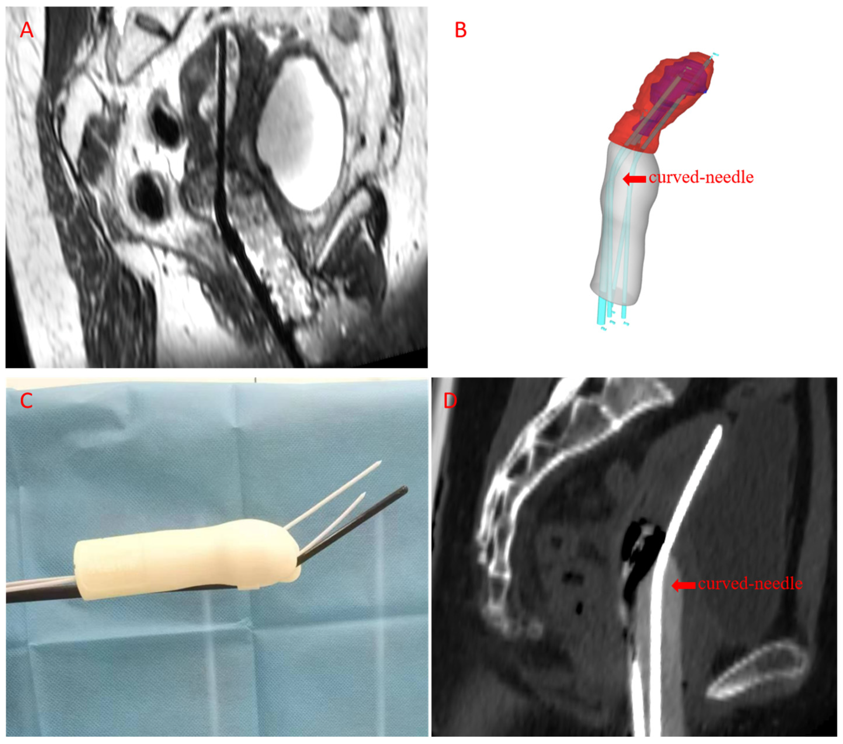 A Novel Three-Dimension Printed Individualized Curved-Needle-Based ...