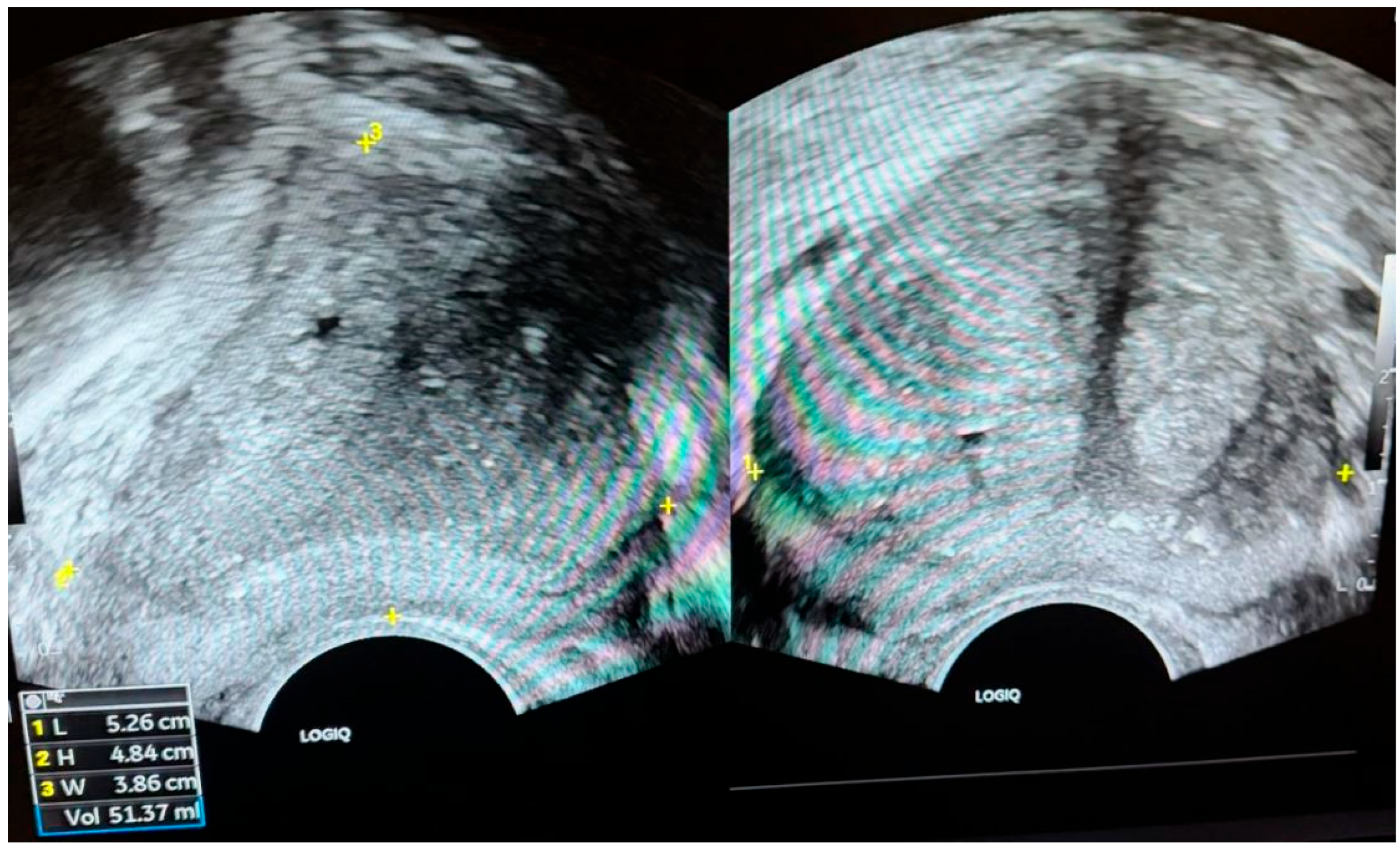 Diagnostic and Clinical Impact of Imaging Modality on PSA Density: TRUS ...